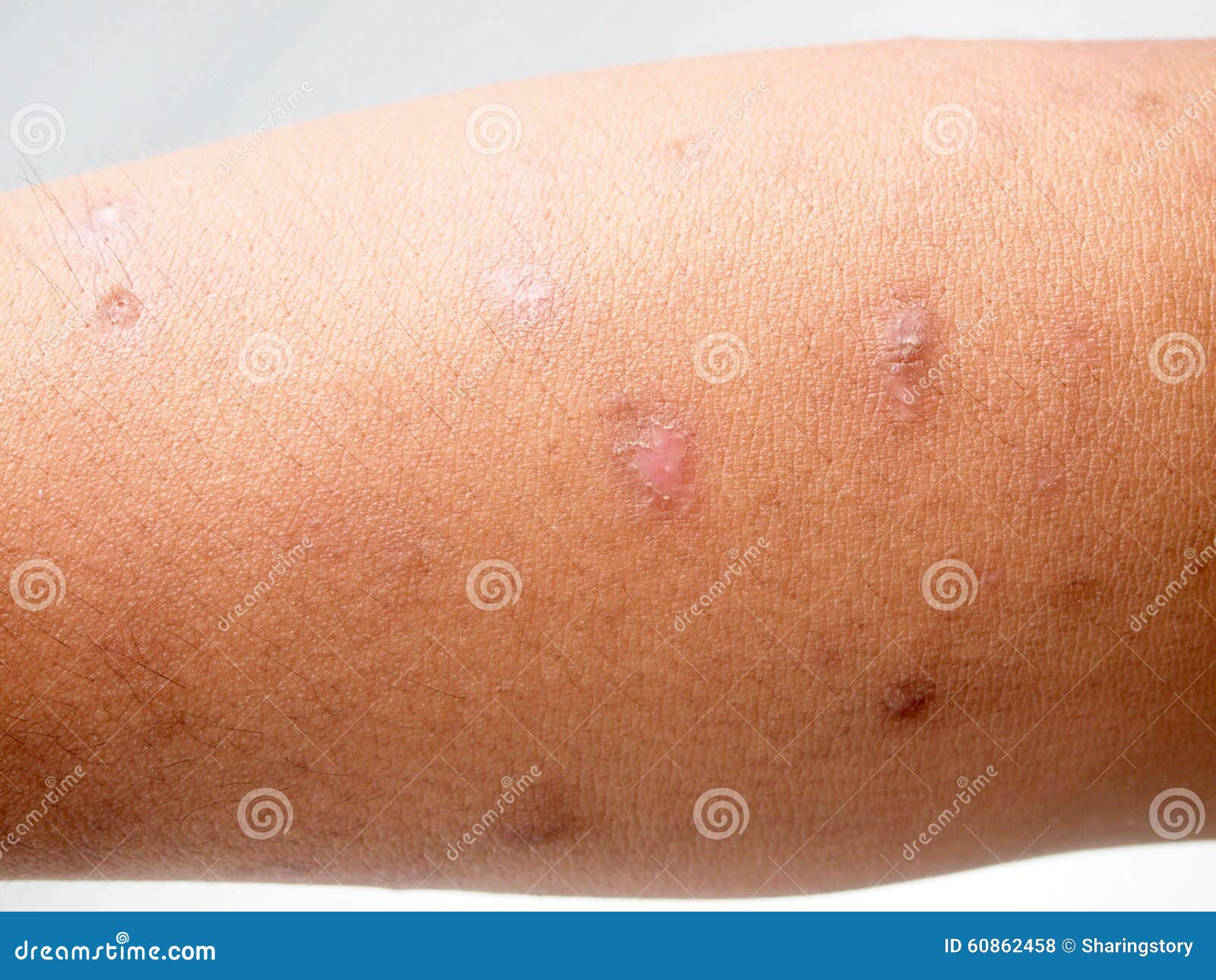 Scar on the skin. macro stock photo. Image of heal, human - 60862458