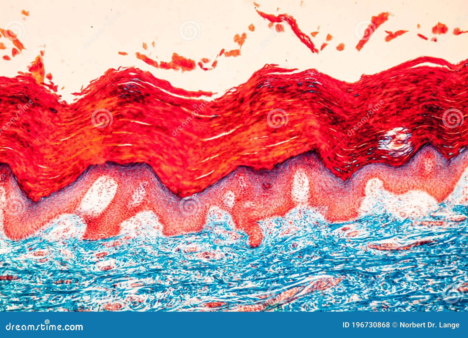 Scar. Skin Wound. Plastic Surgery. Scarification. White Skin With A ...