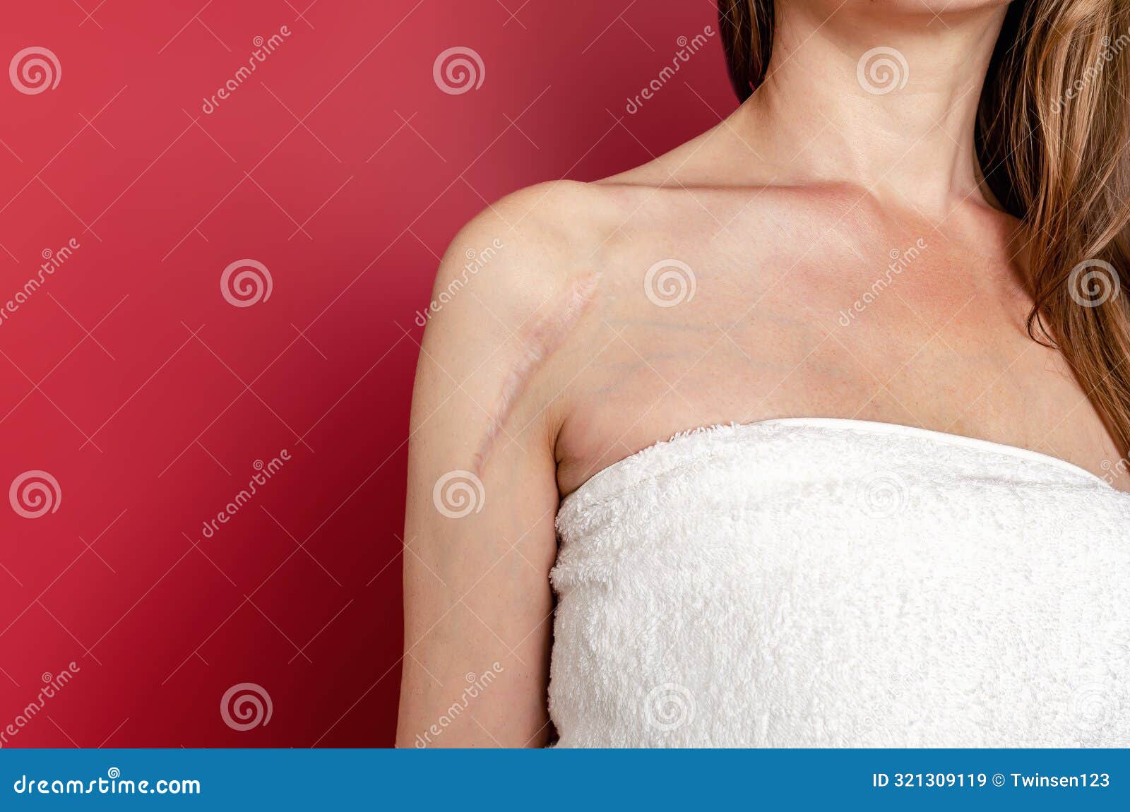 Scar after Surgery on a Woman Shoulder on Red Background Stock Image ...