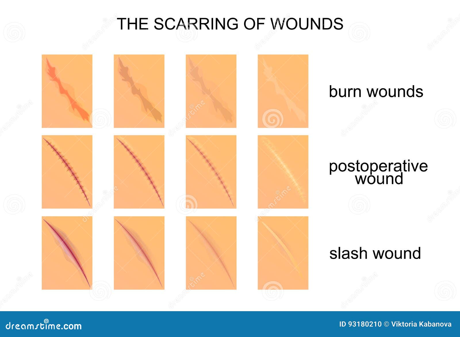 The scarring of wounds stock vector. Illustration of derma - 93180210