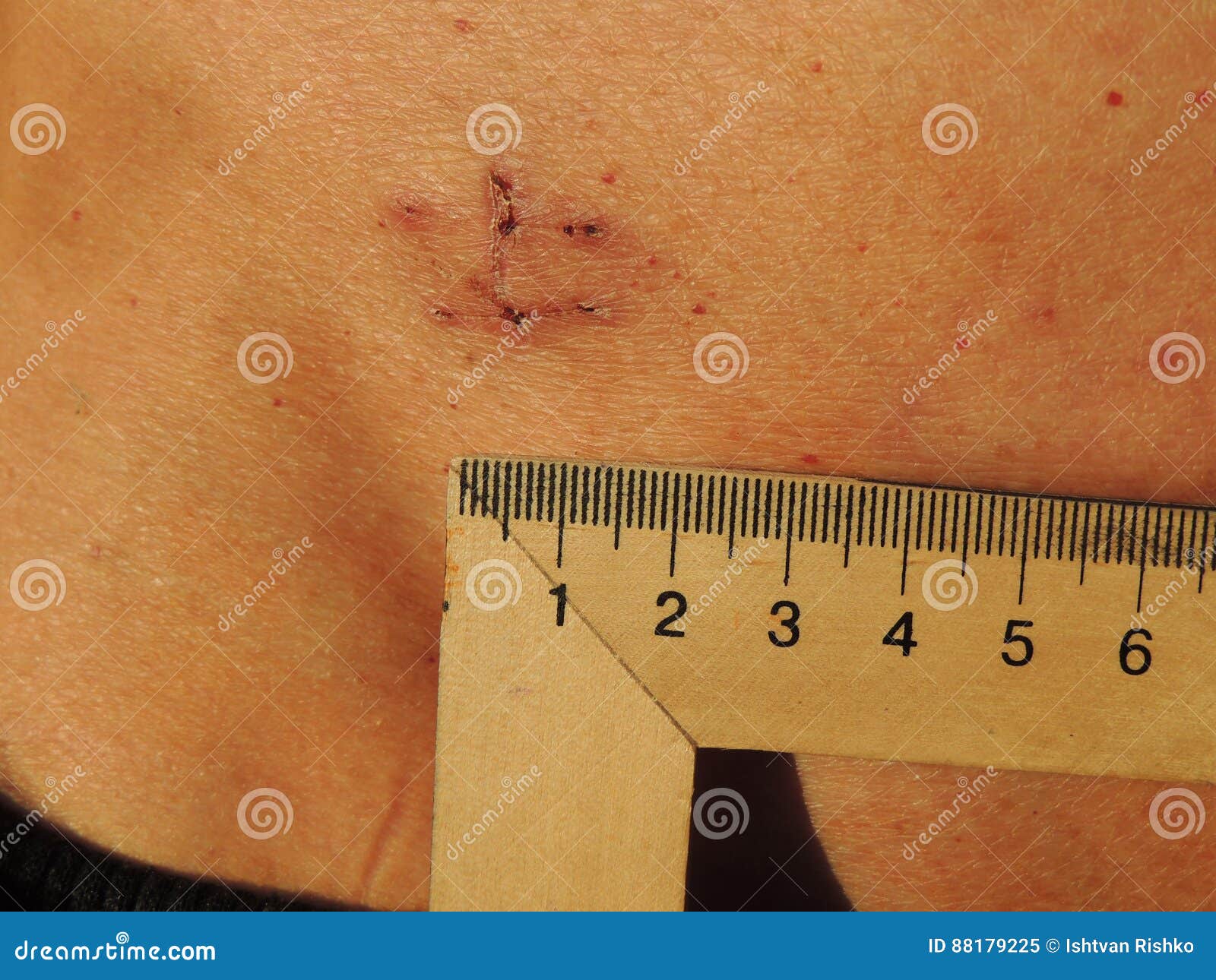 Scars on the Abdomen of Patient Stock Image - Image of surgery, macro ... Scars on the Abdomen of Patient Stock Image - Image of surgery, macro ...