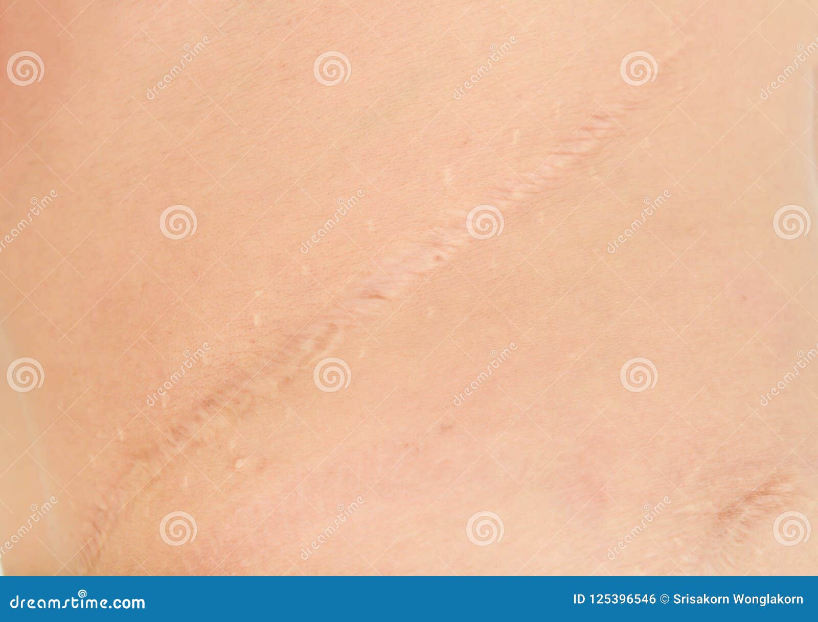 Scars in the body stock photo. Image of female, recovering - 125396546