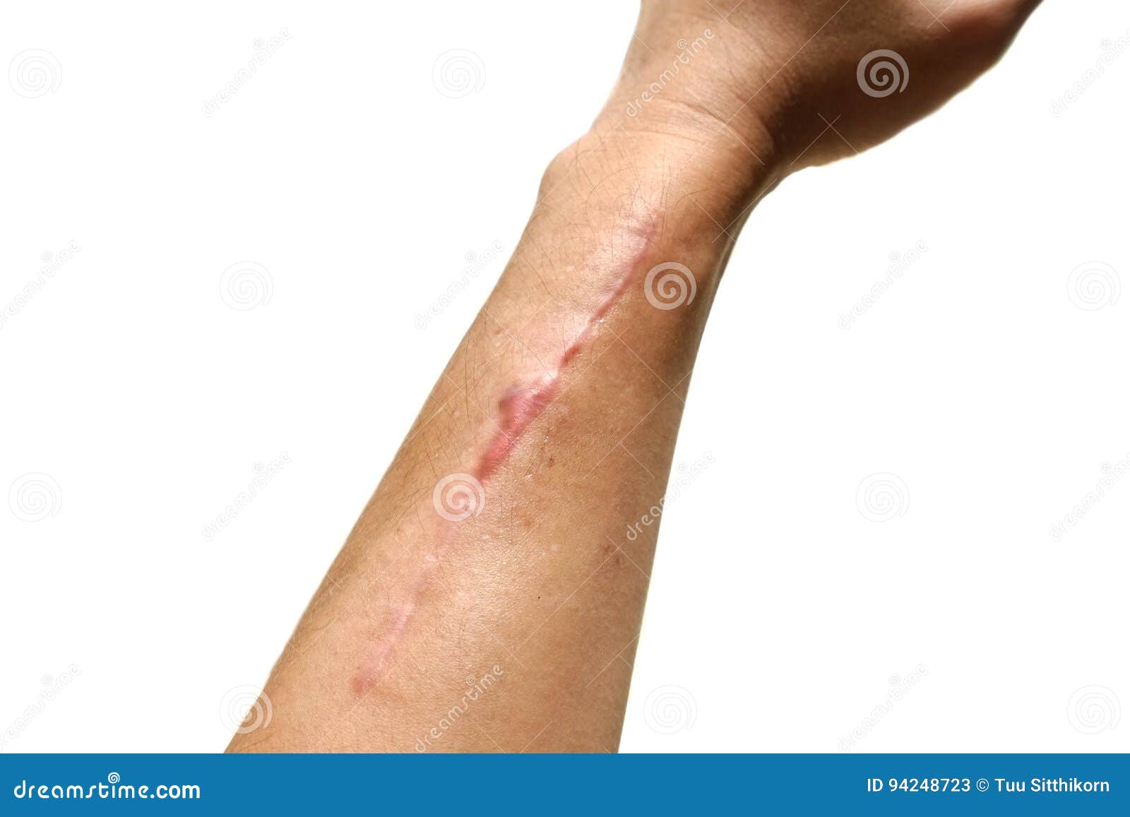 Scars from Broken Arm Surgery on White Background Stock Image - Image ...