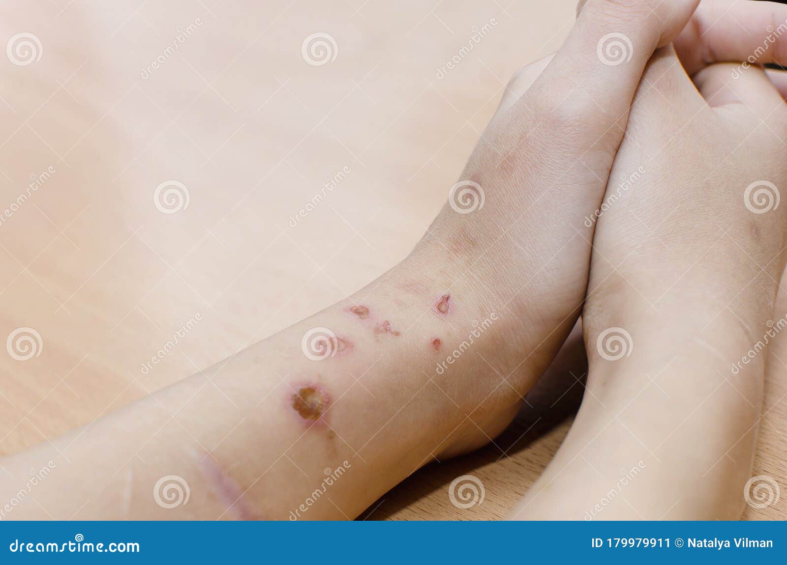 Scars from Cuts and Burns on the Arm Stock Image - Image of burns ...