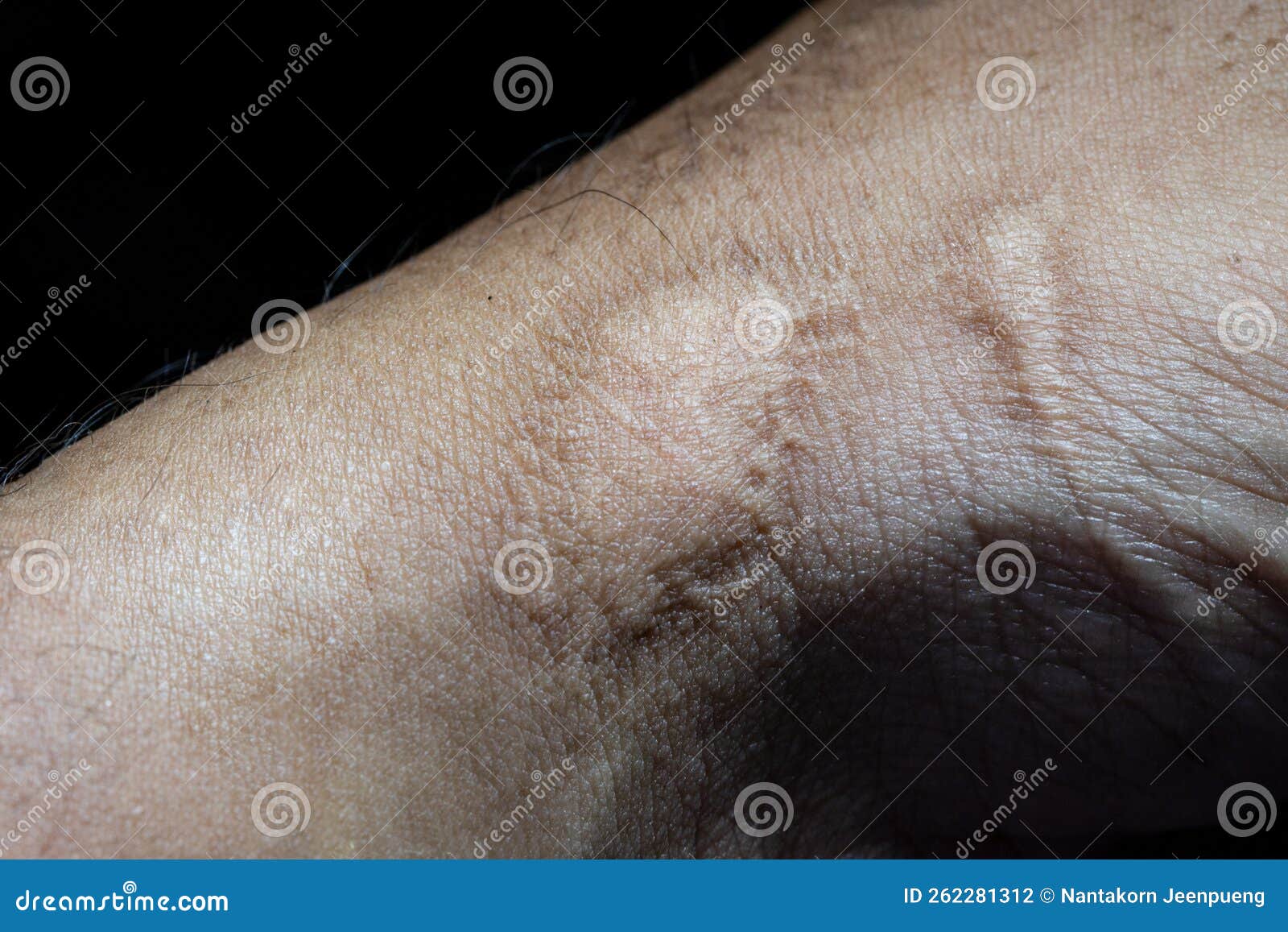 Scars Formed on the Human Body Stock Photo - Image of anatomy, surgery ...