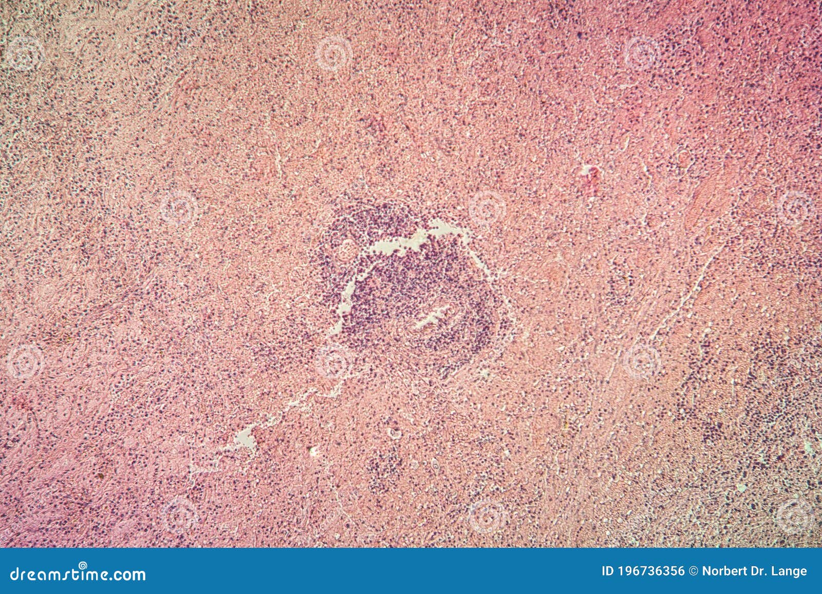 Scars in the Heart Muscle Tissue Stock Photo - Image of medicine, heart ...