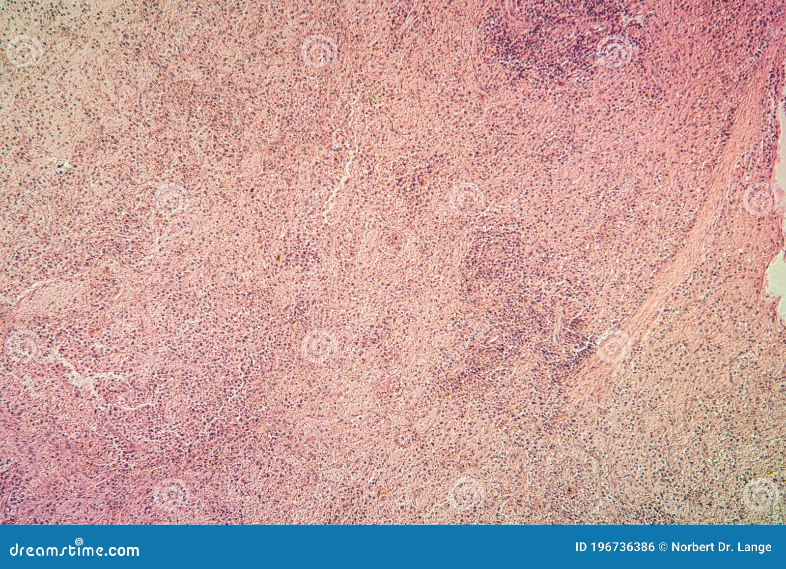 Scars in the Heart Muscle Tissue Stock Photo - Image of tissue, disease ...