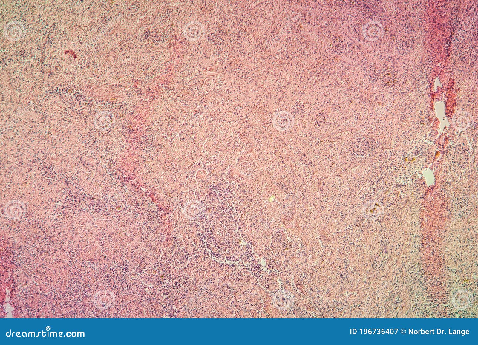 Scars in the Heart Muscle Tissue Stock Image - Image of macro, scars ...