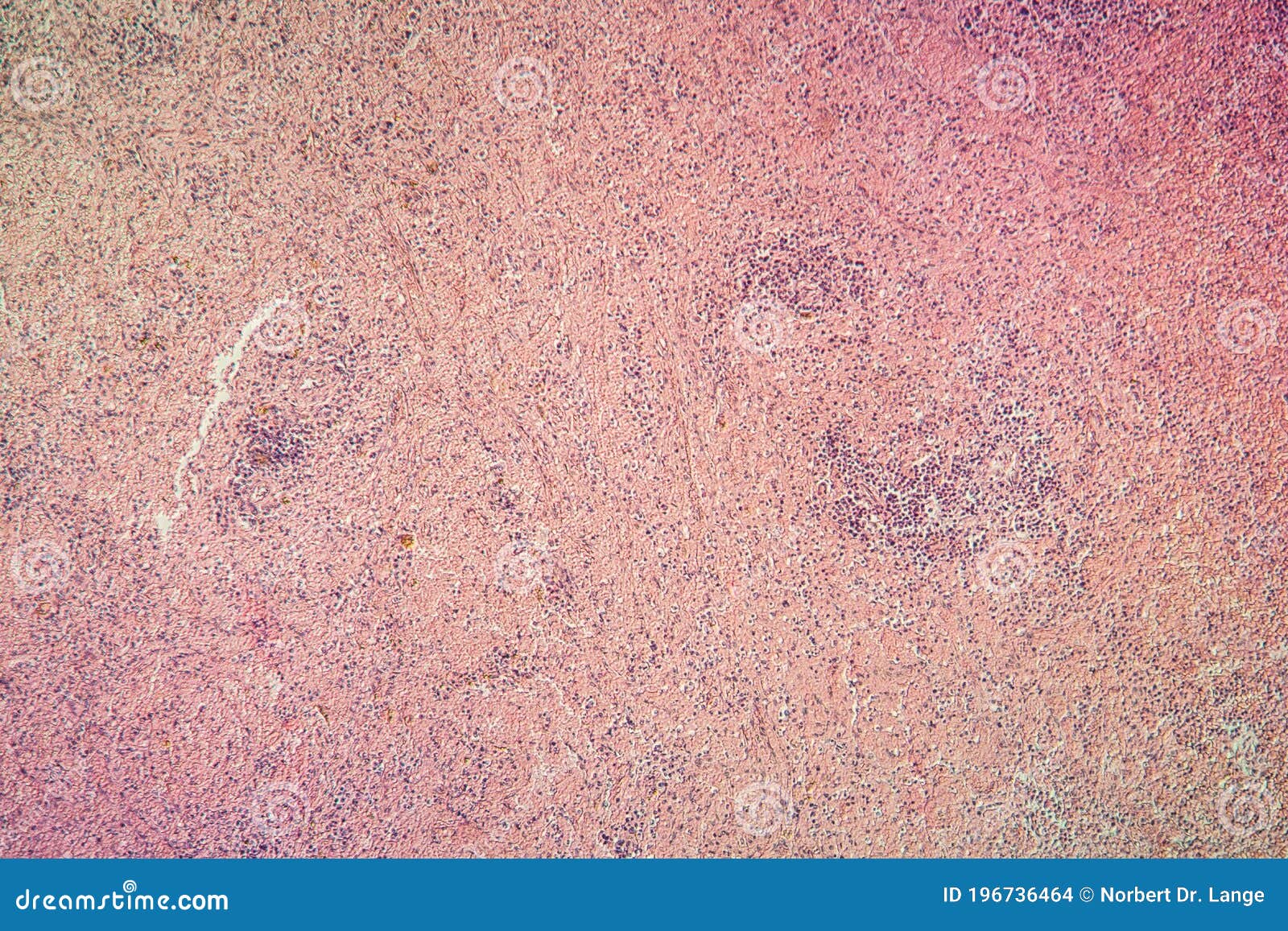 Scars in the Heart Muscle Tissue Stock Photo - Image of scars, science ...