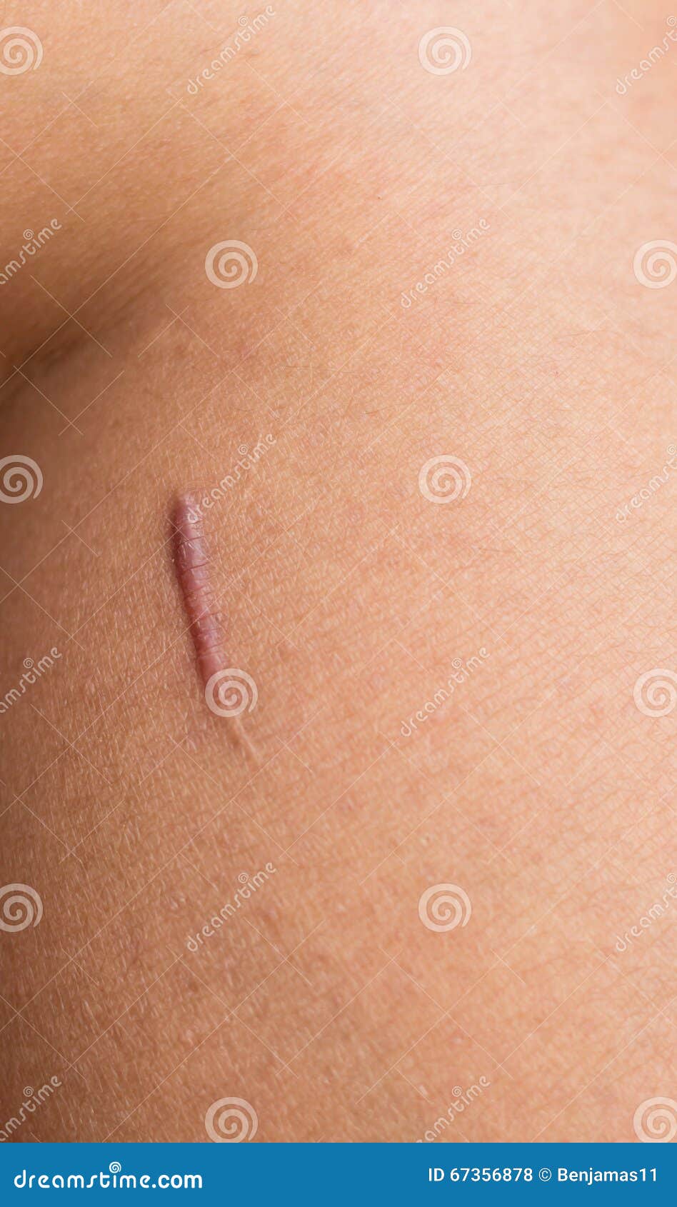 Scars stock photo. Image of scar, surgery, healthcare - 67356878