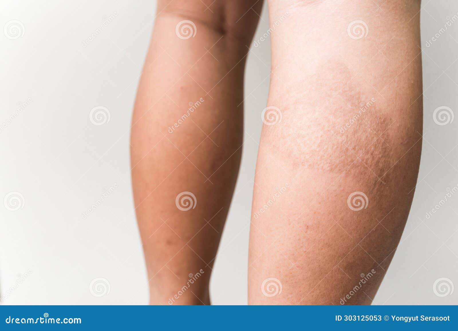 Scars on the Skin Around Legs Stock Image - Image of bump, deformed ...