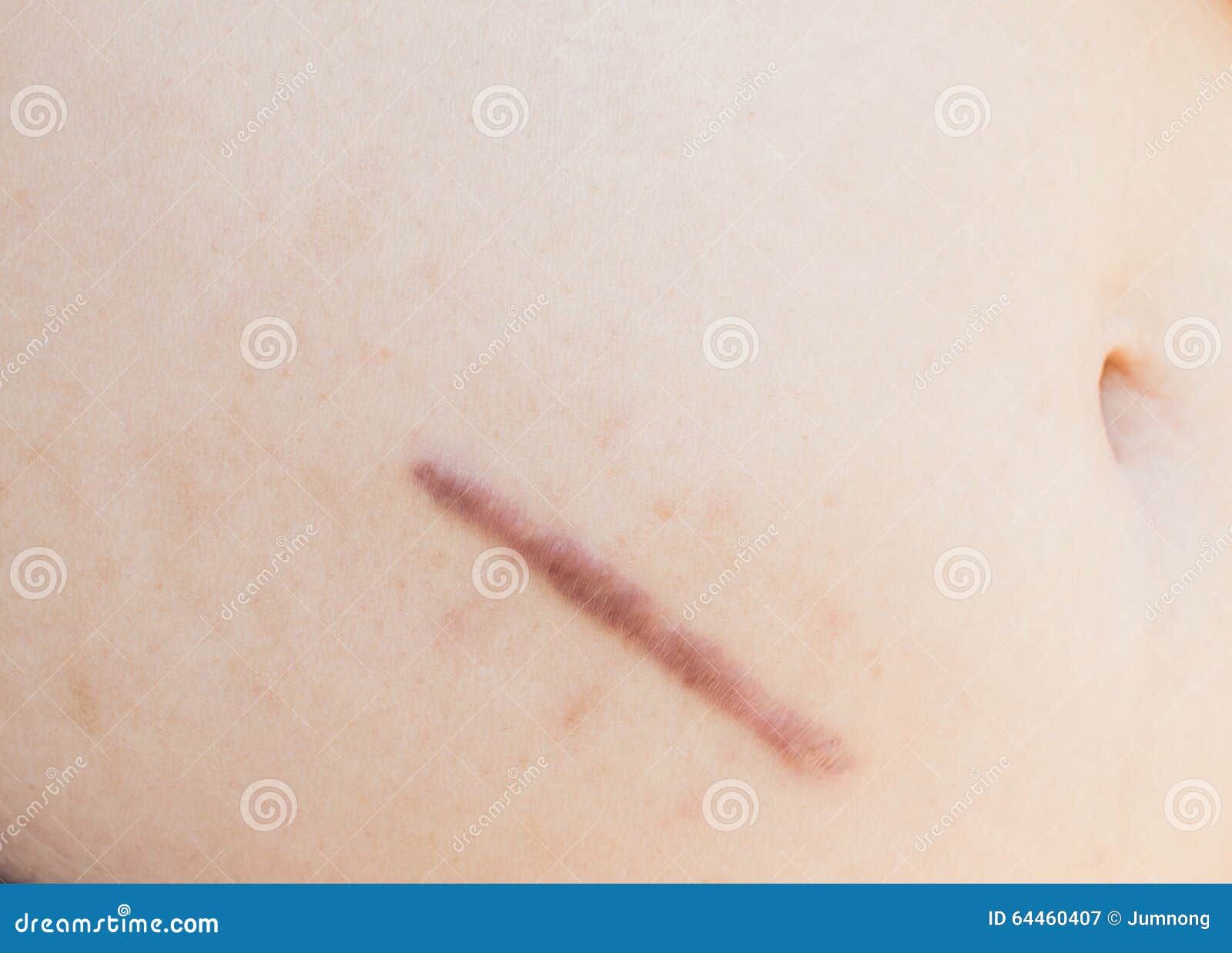 Scars from surgery stock image. Image of human, wound - 64460407