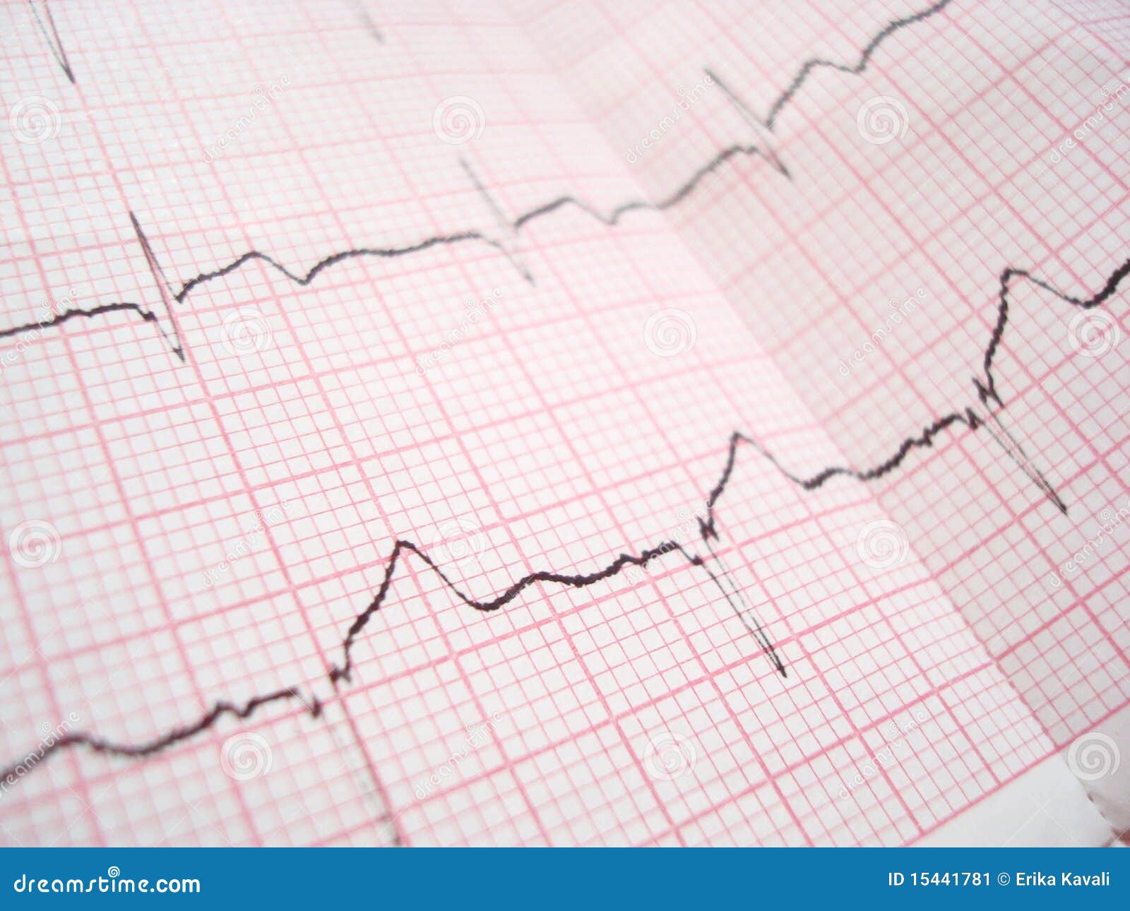 Schema Di Elettrocardiografia Di ECG Immagine Stock - Immagine di ...