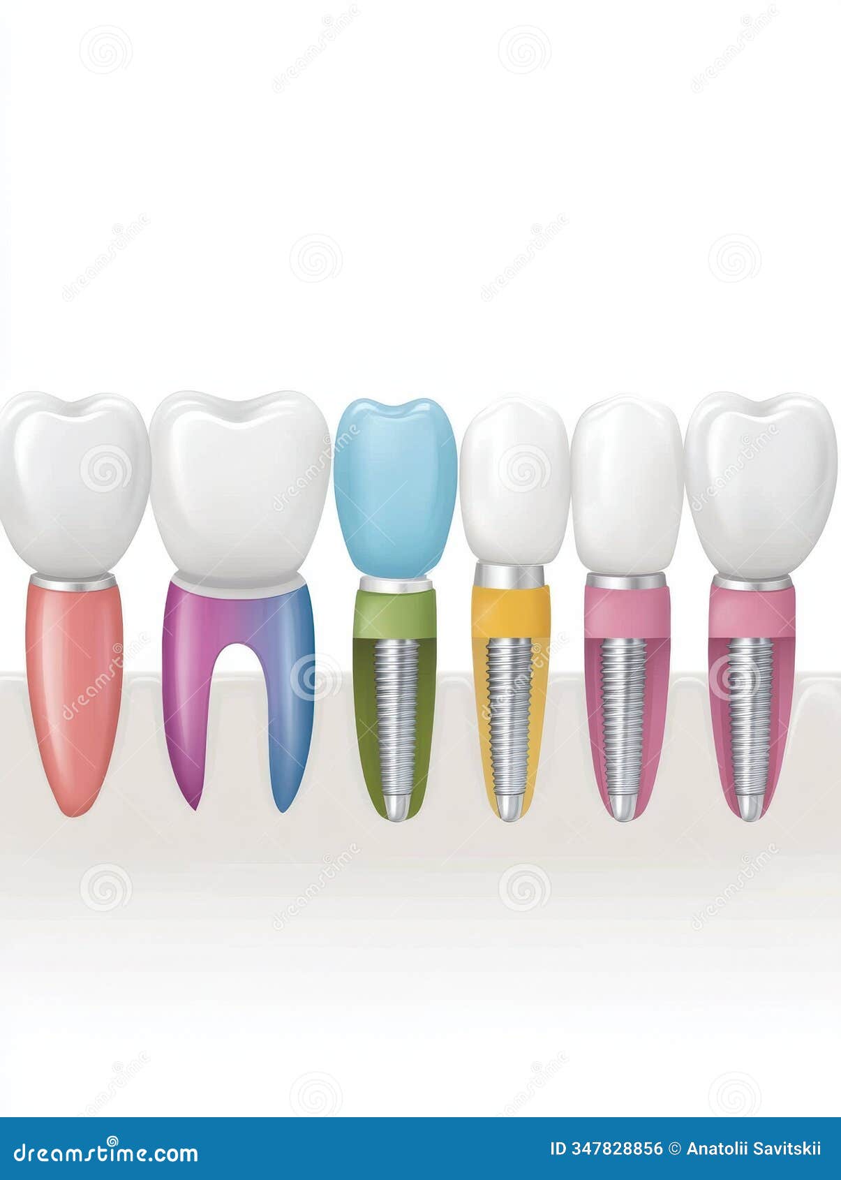 Schematic Illustrates a Row of Healthy Teeth with Colored Dental ...