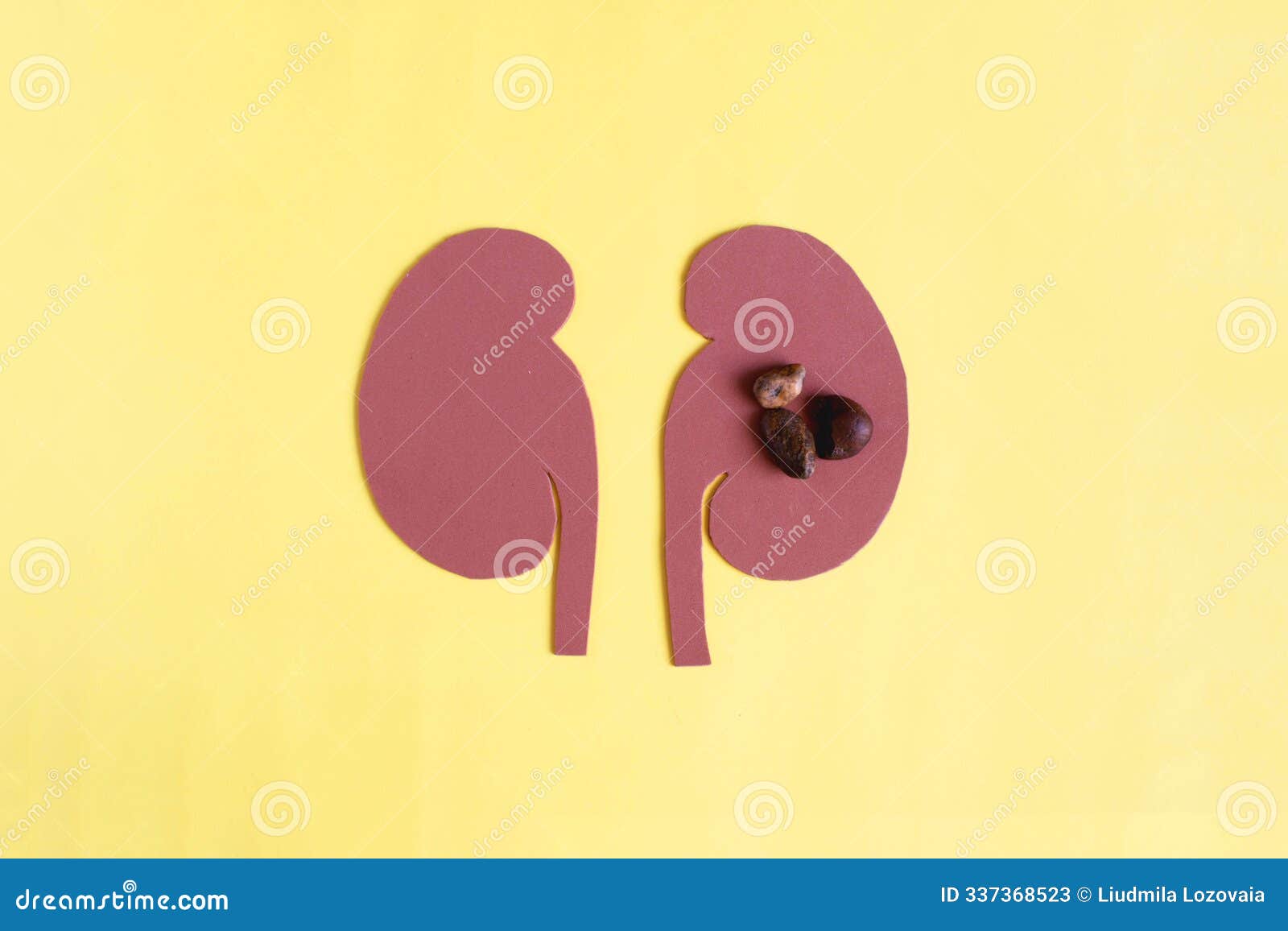 Schematic Image of Kidneys and Stones in Them in Close-up Stock ... Schematic Image of Kidneys and Stones in Them in Close-up Stock ...
