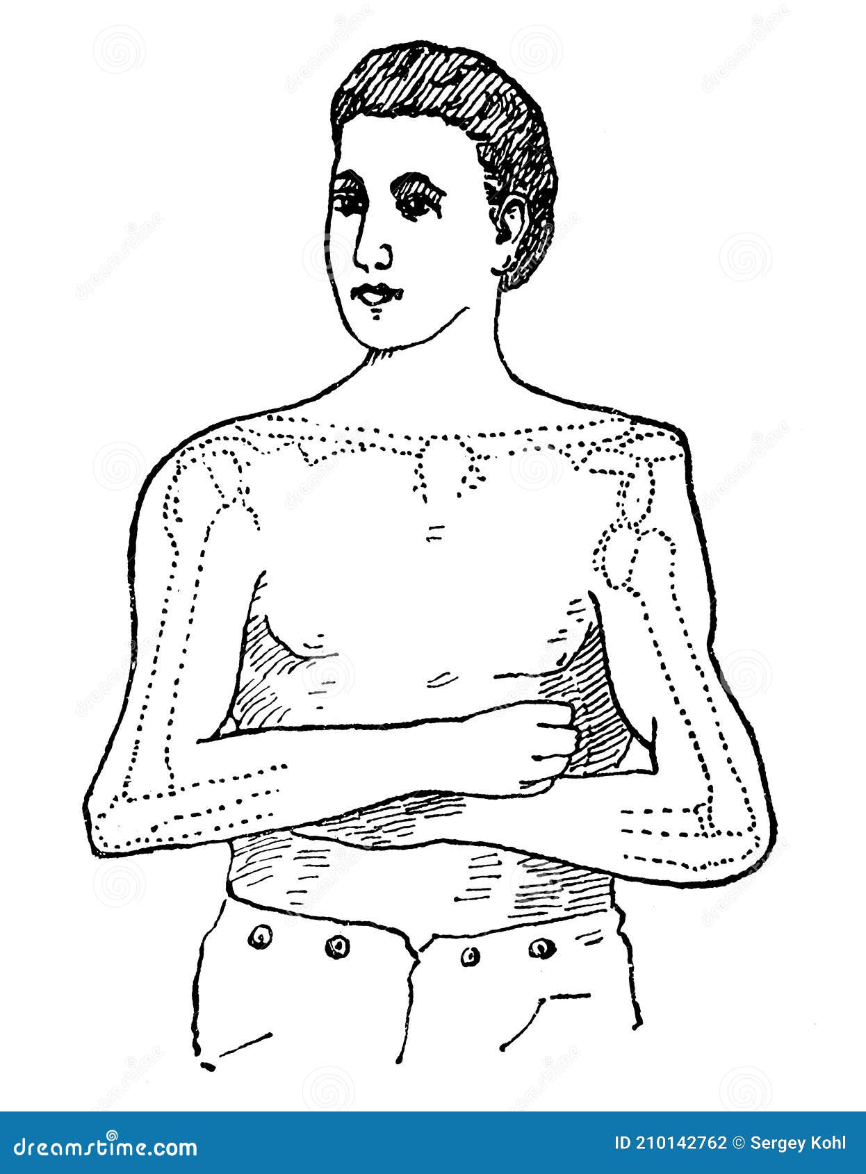 Schematic Representation Of The Dislocation Of The Shoulder Joint ... Schematic Representation Of The Dislocation Of The Shoulder Joint ...