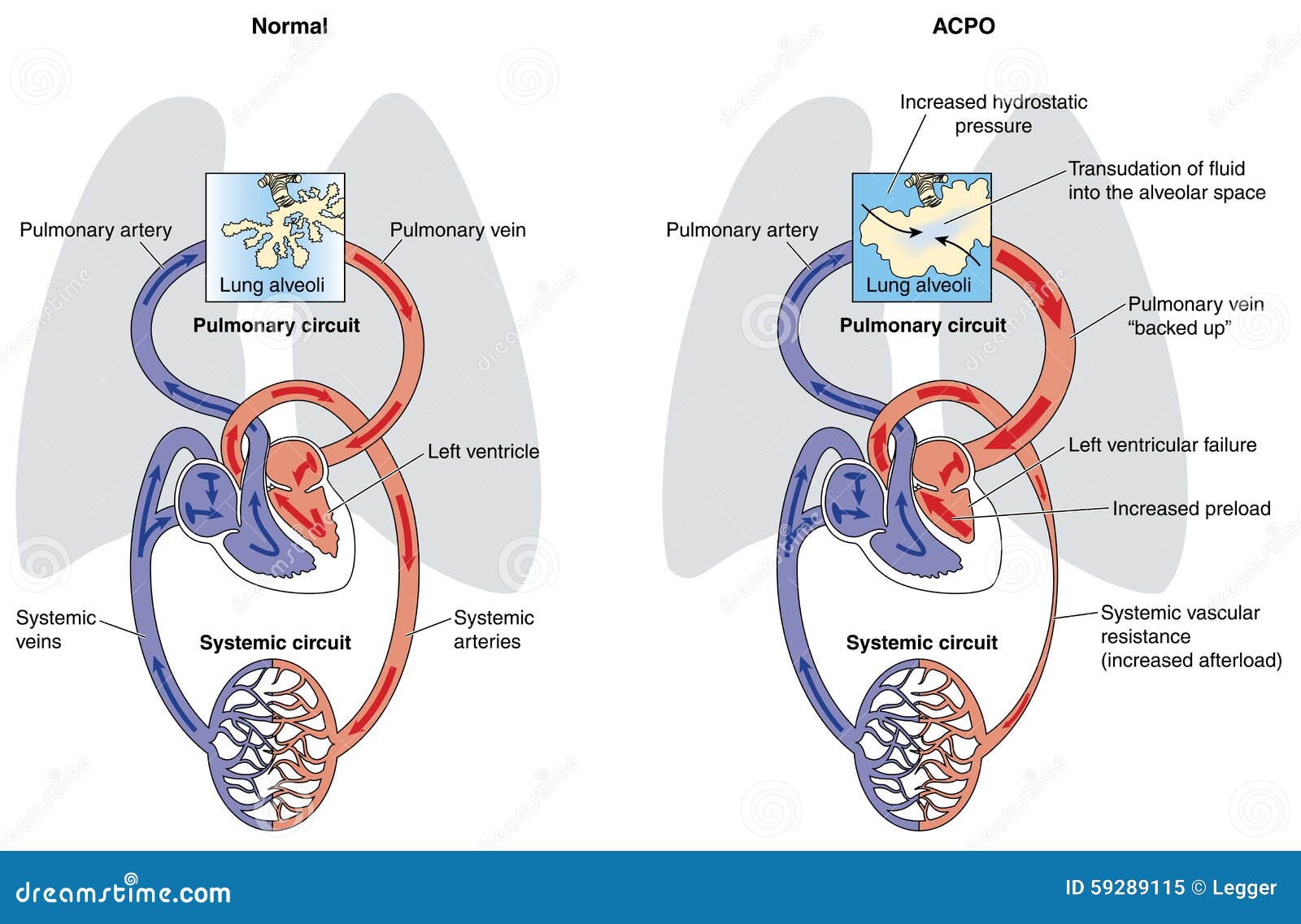 Scherp Cardiogenic Longoedeem Vector Illustratie - Illustration of ader ...