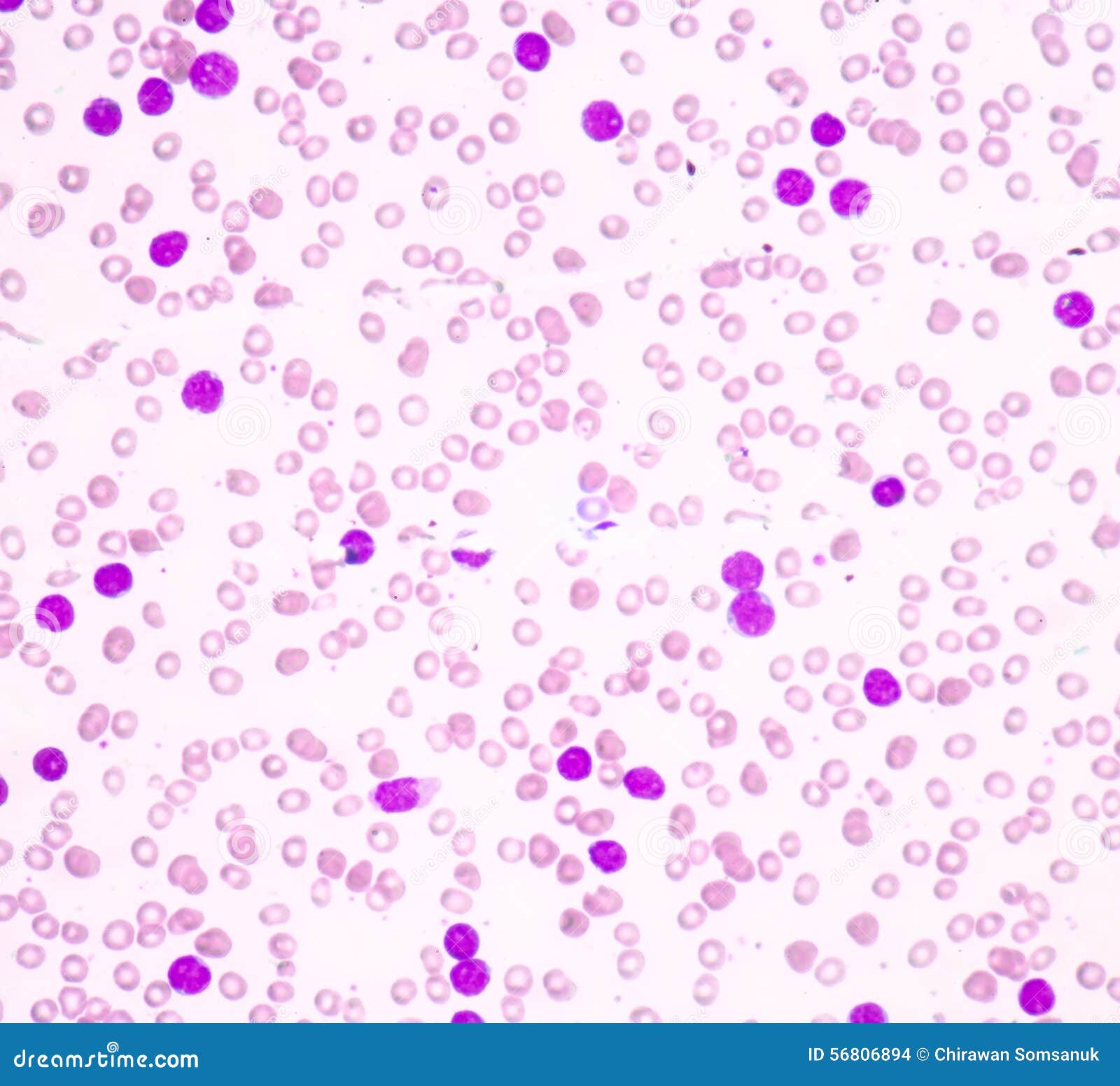 Scherpe Lymphoblastic Leukemie (ALLEN) Stock Foto - Image of ...