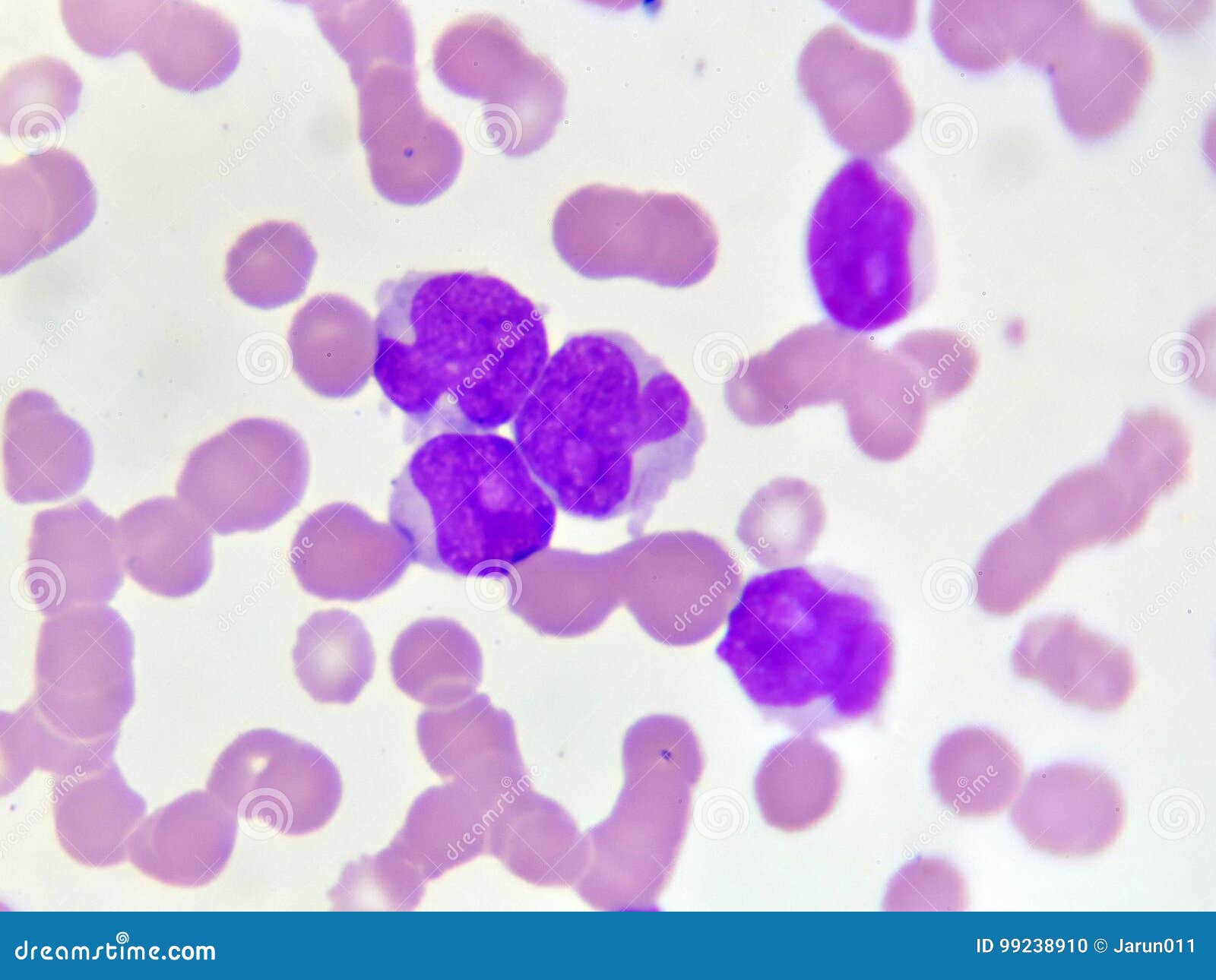 Scherpe myeloid leukemie stock foto. Image of rood, leukemie - 99238910