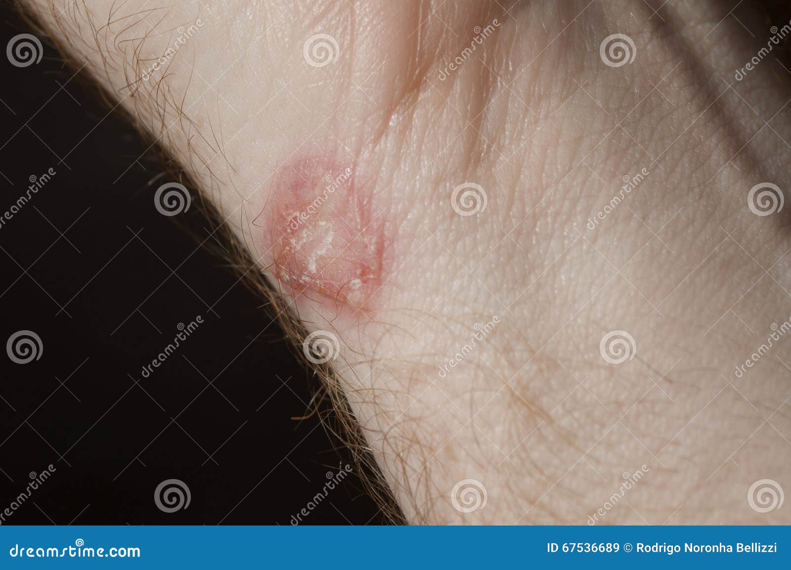 Scherpilzflechte Auf Weißem Mann/Mykose Stockbild - Bild von menschlich ...