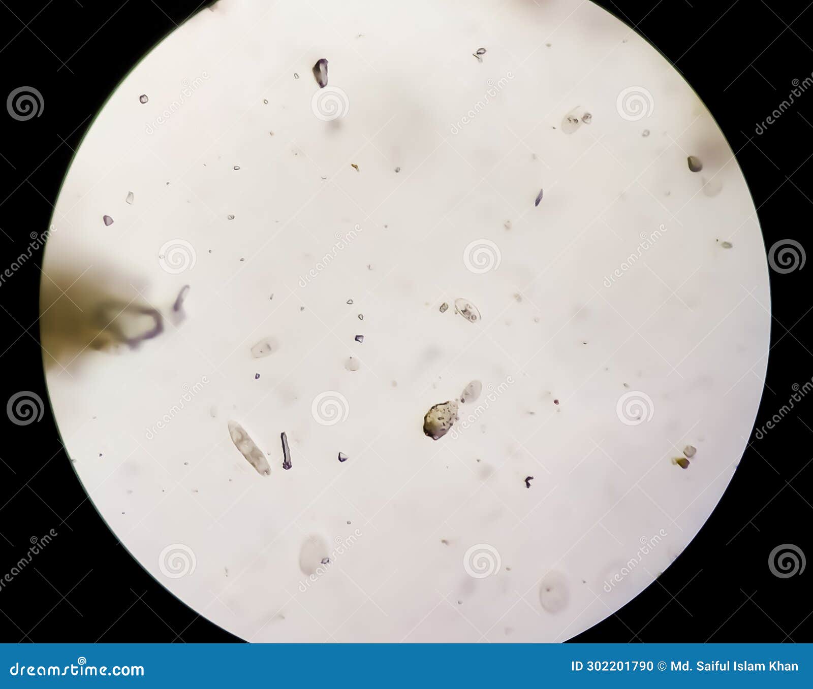 Schistosoma Parasite and Ova in Human Urine Specimen Under Microscope ...