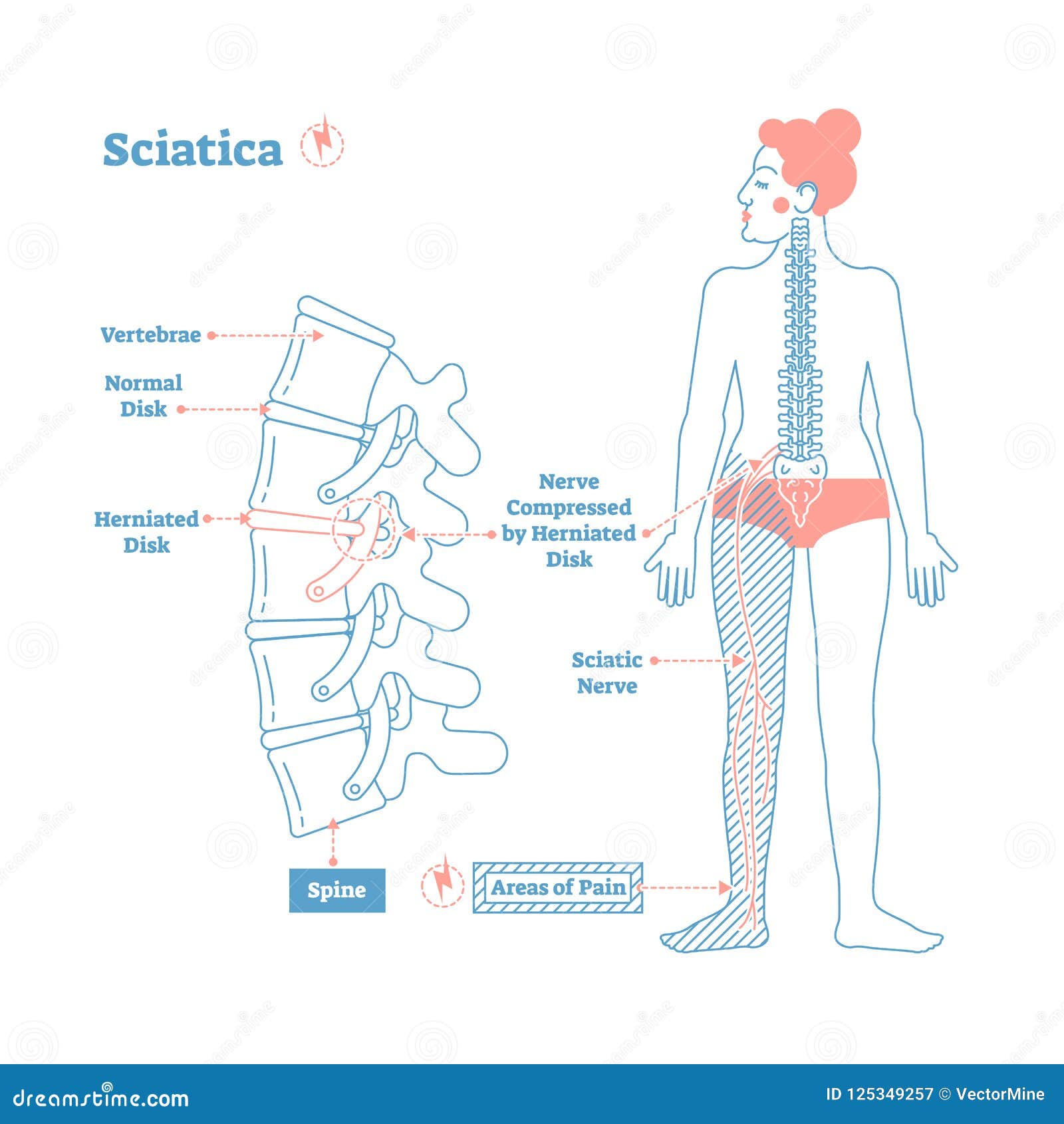 Sciatica As Symptom From Herniated Disc And Spinal Nerve Outline ... Sciatica As Symptom From Herniated Disc And Spinal Nerve Outline ...