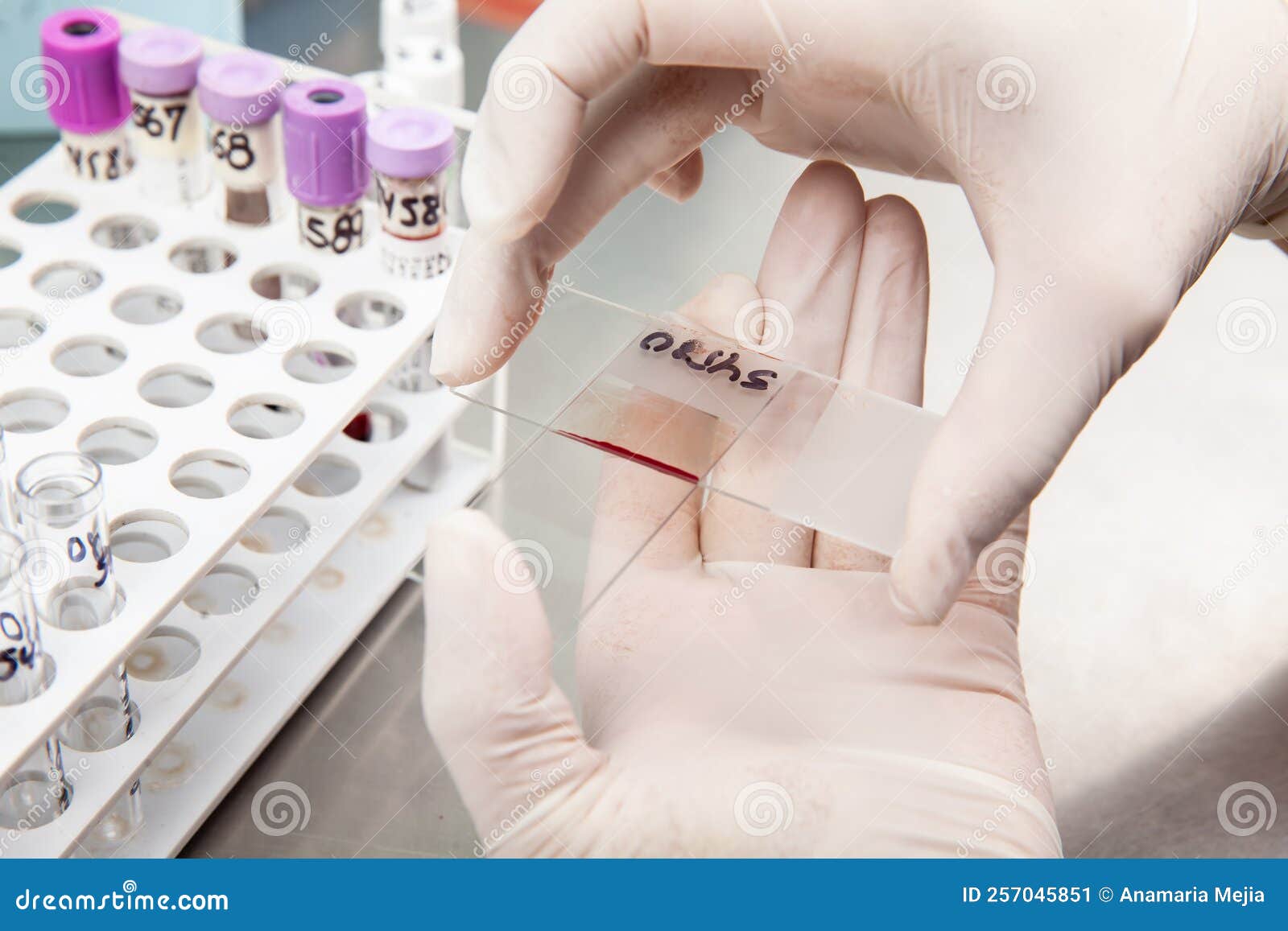 Scientist Preparing a Bone Marrow Smear in the Laboratory. Blood Smear ...
