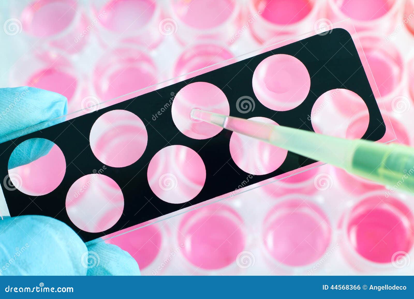 Microscope Slide Staining Tissue Biopsy For Diagnosis In Pathology ...