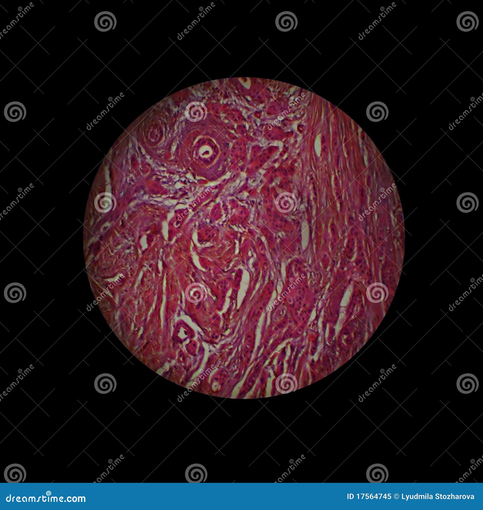 Scirrhus of mammary gland stock image. Image of micro - 17564745