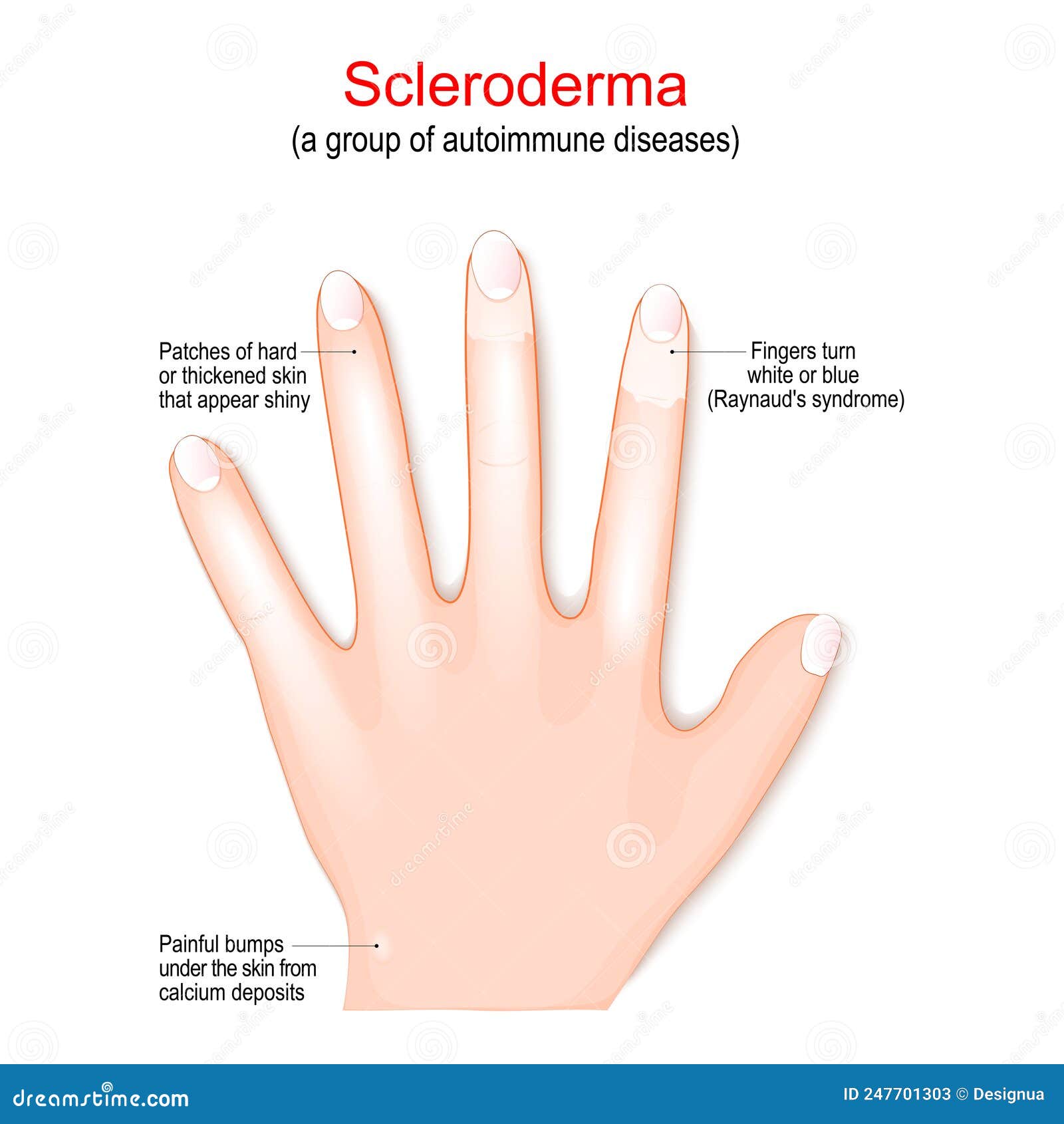 Scleroderma. Autoimmune Disease. Signs and Symptom Stock Vector ...