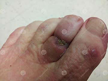 Scleroderma Patient with Two Severe Toe Ulcerations Stock Photo - Image ...