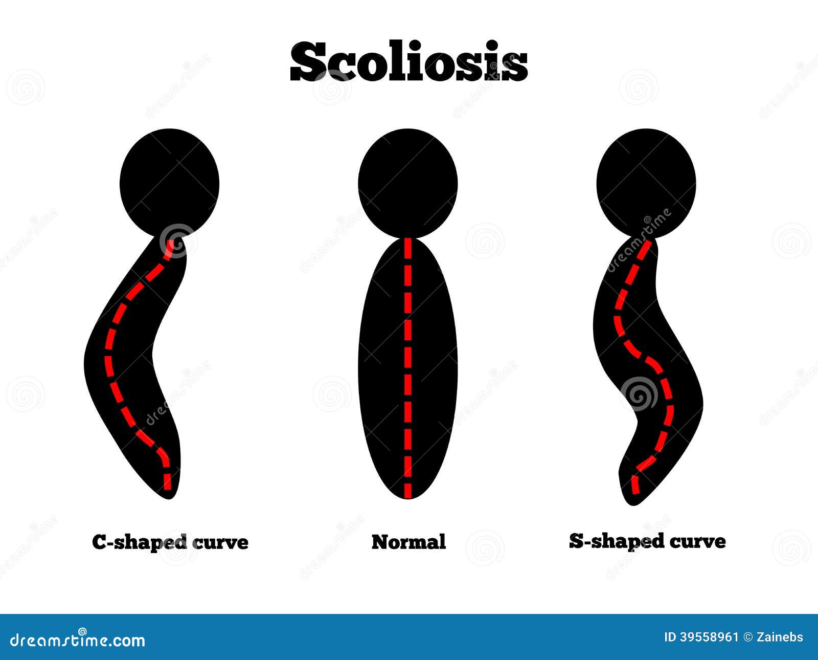 Scoliose illustration de vecteur. Illustration du fuselage - 39558961