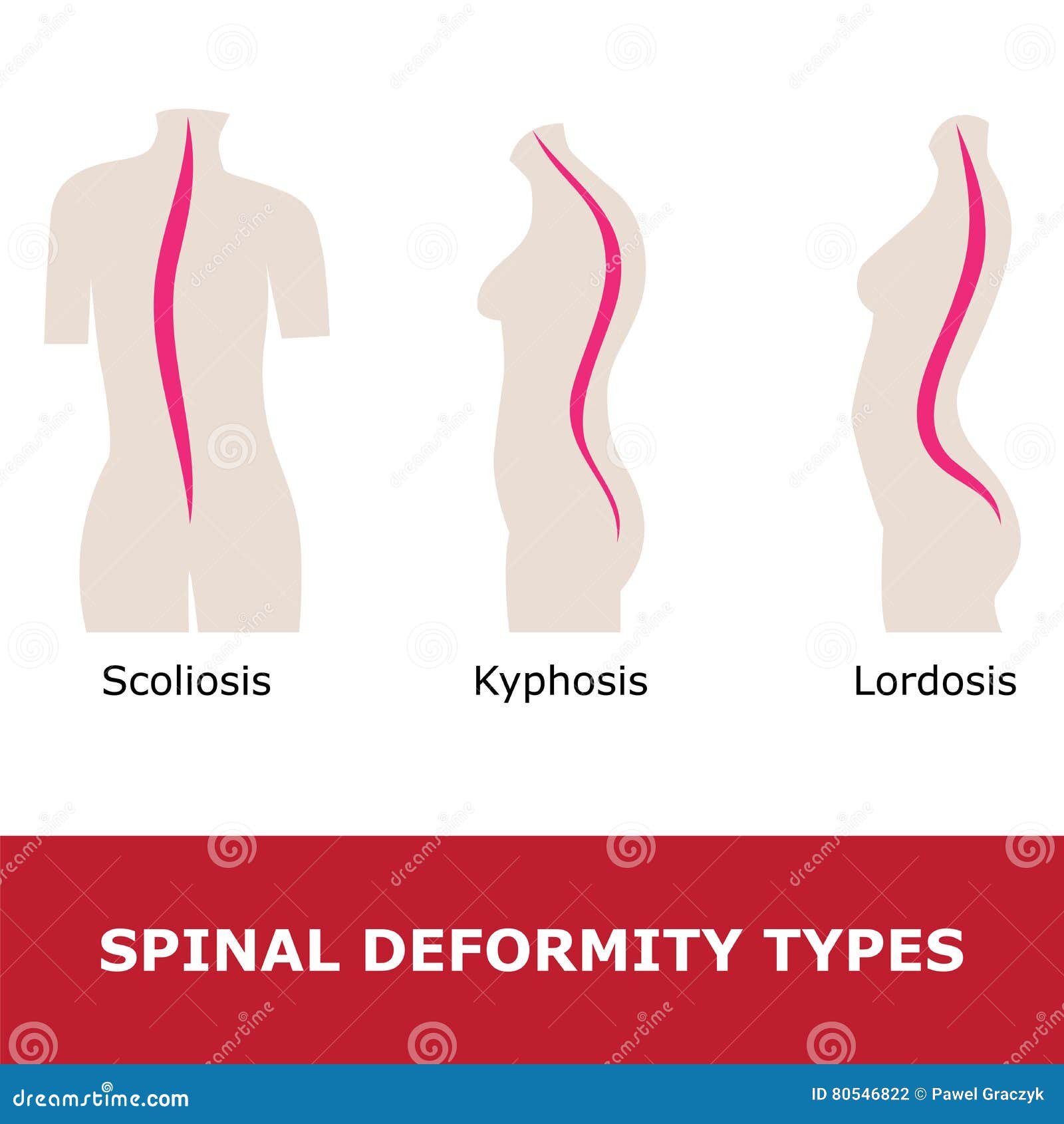 Scoliose, Lordose En Kyfose Vector Illustratie - Illustration of been ...