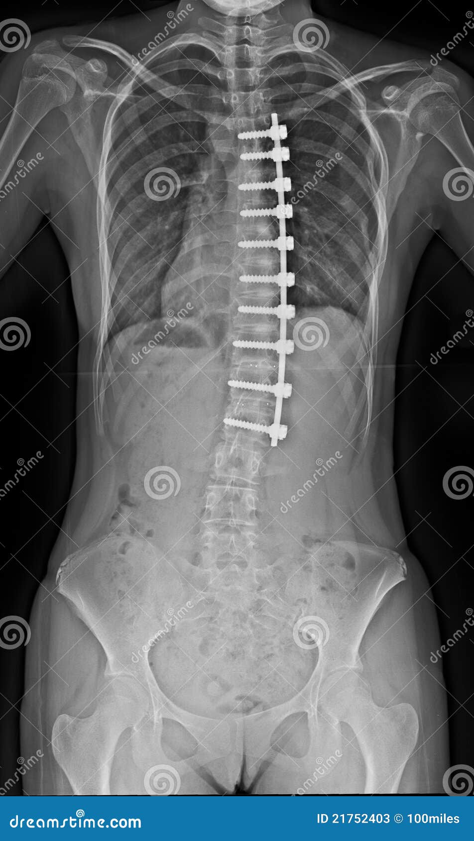 Scoliosis stock image. Image of diagnostic, column, cauda - 21752403