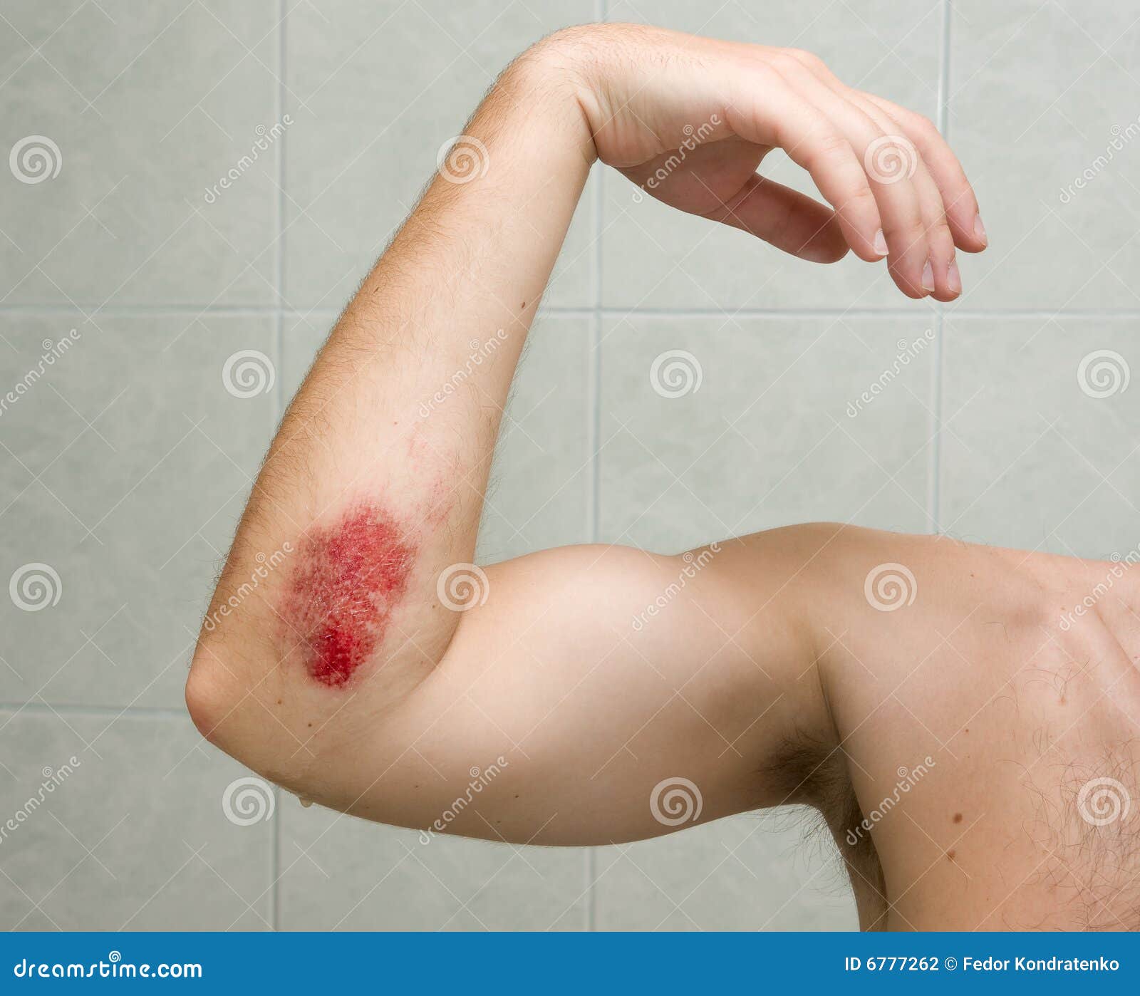 Scraped elbow #1 stock photo. Image of pain, scratch, skin - 6777262