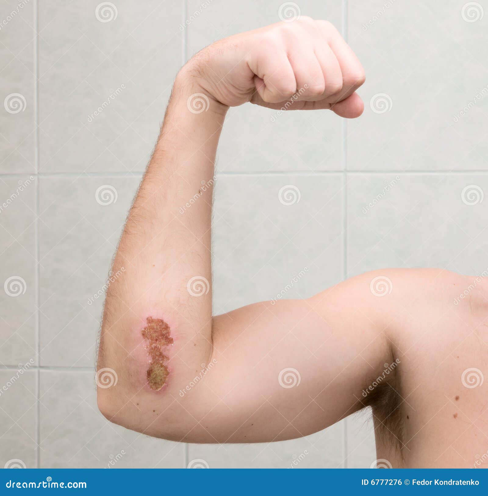 Scraped Elbow #3 - 9 Days after Accident. Stock Photo - Image of hairy ...