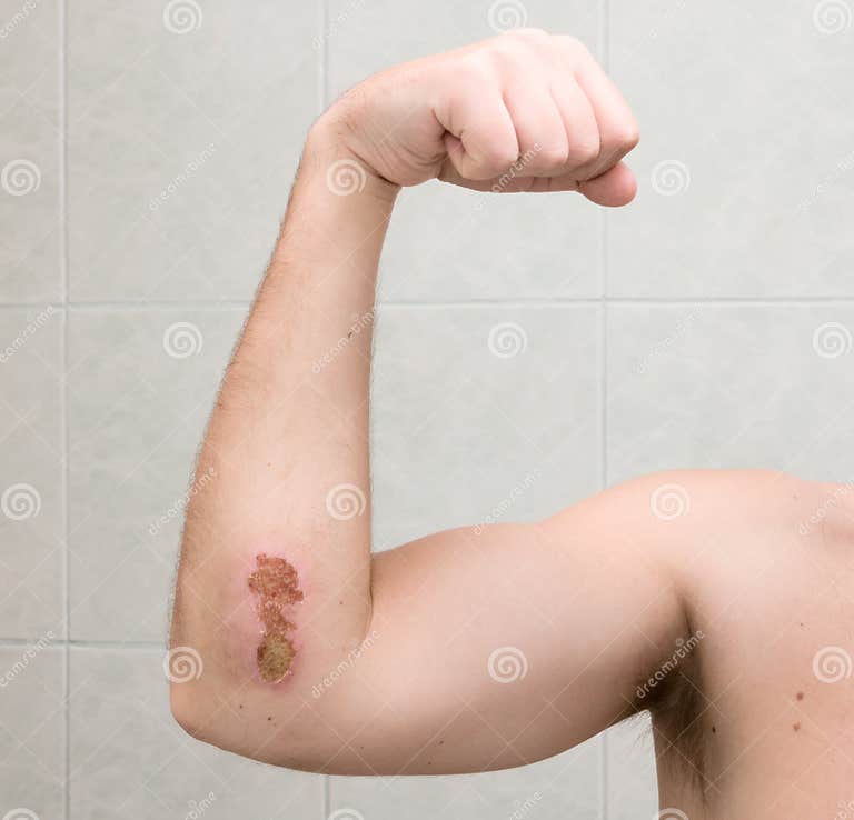 Scraped Elbow #3 - 9 Days after Accident. Stock Photo - Image of hairy ...