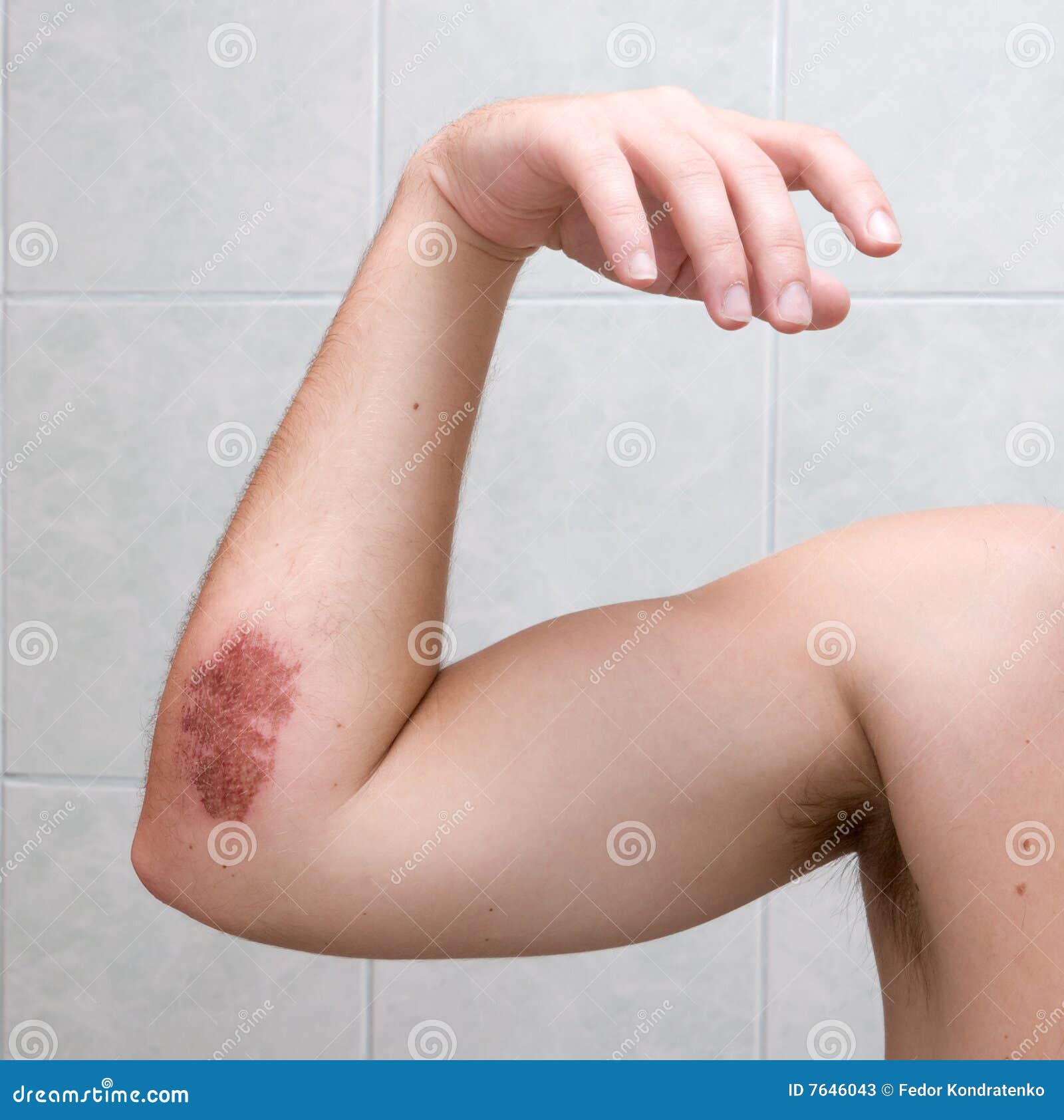 Scraped Elbow - 5 Days after Accident. Stock Image - Image of ...