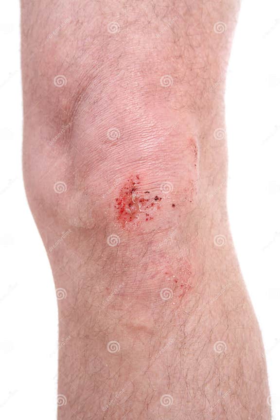 Scraped knee stock photo. Image of injured, fell, hurt - 85203698