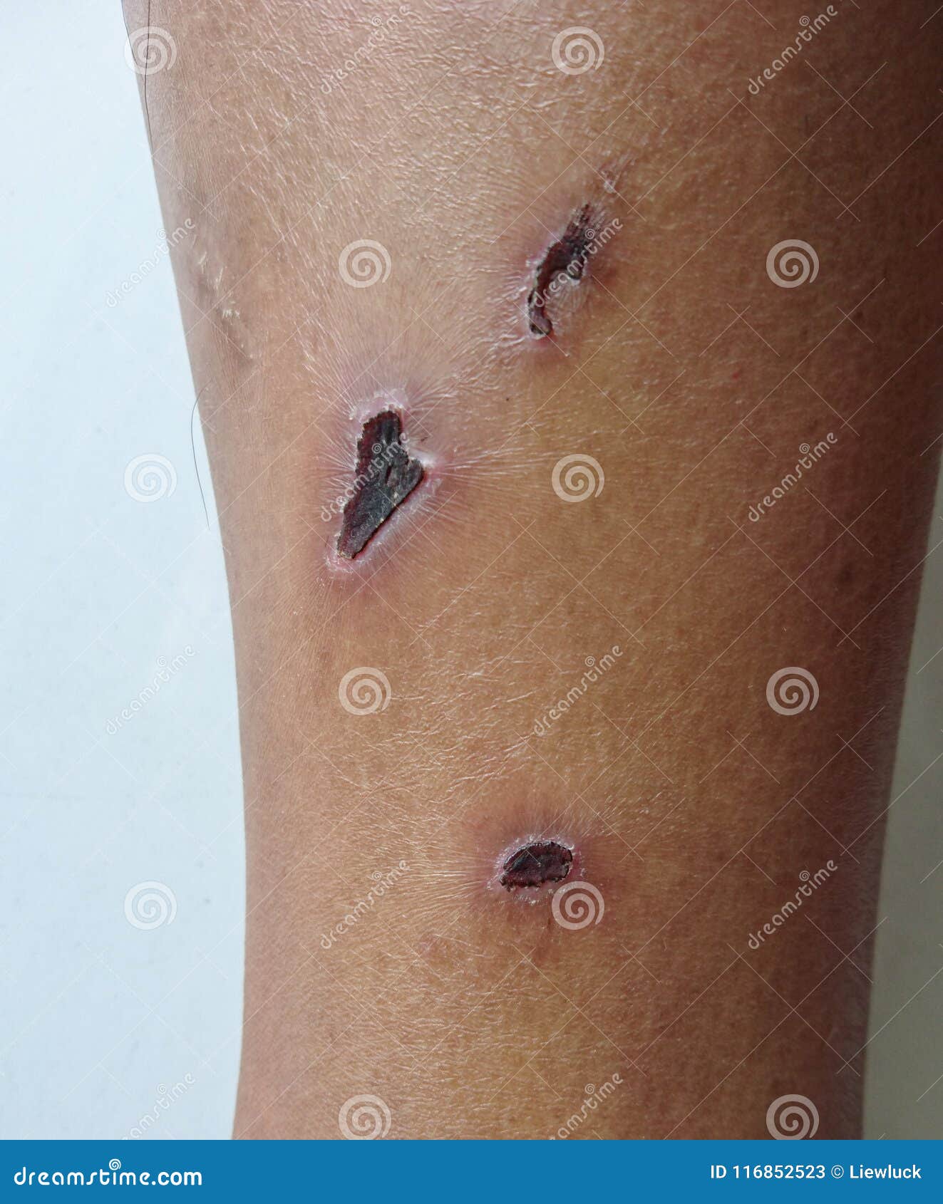 Scraped lesion at shin stock image. Image of scrape - 116852523