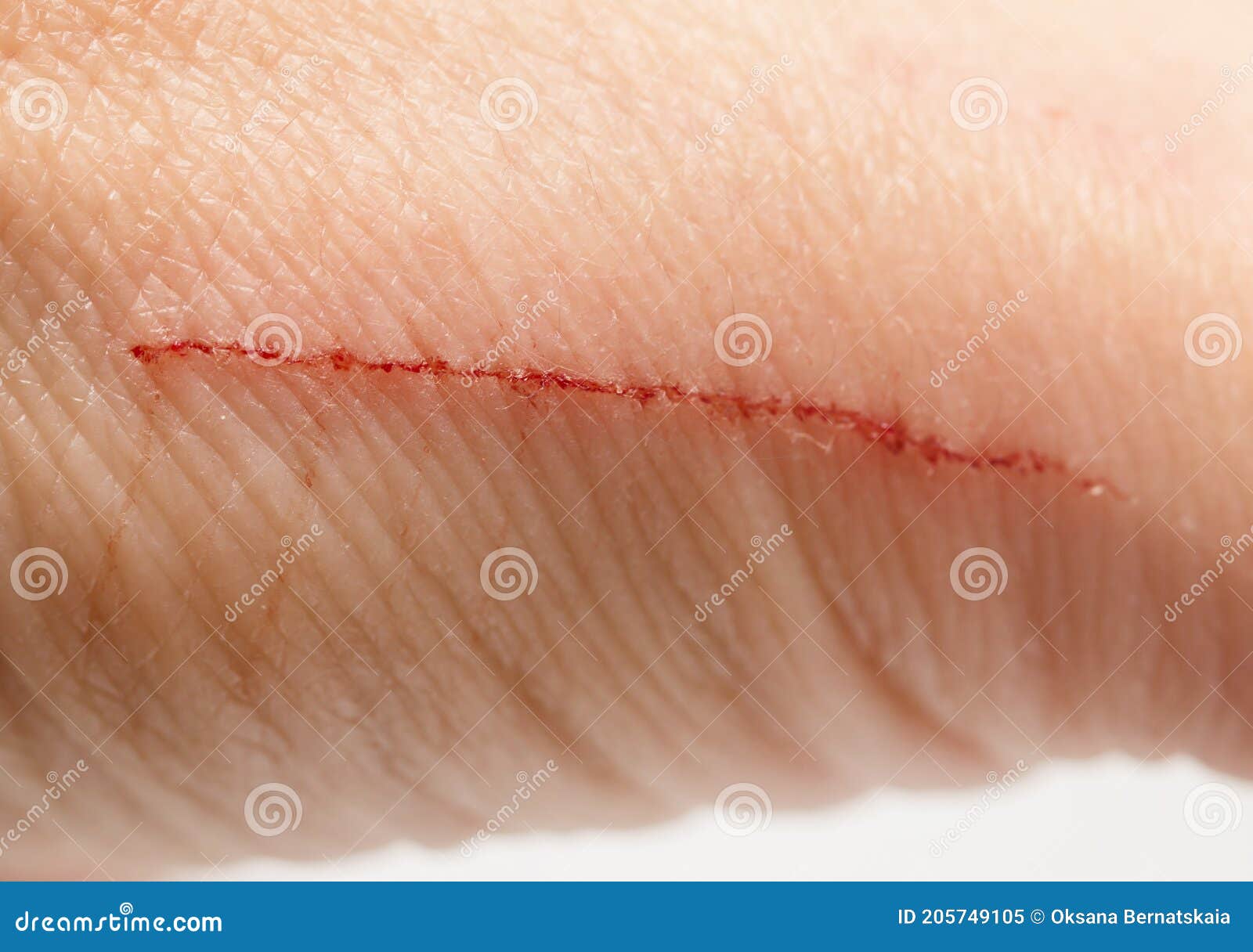 A scratch on the arm stock image. Image of blood, scratch - 205749105
