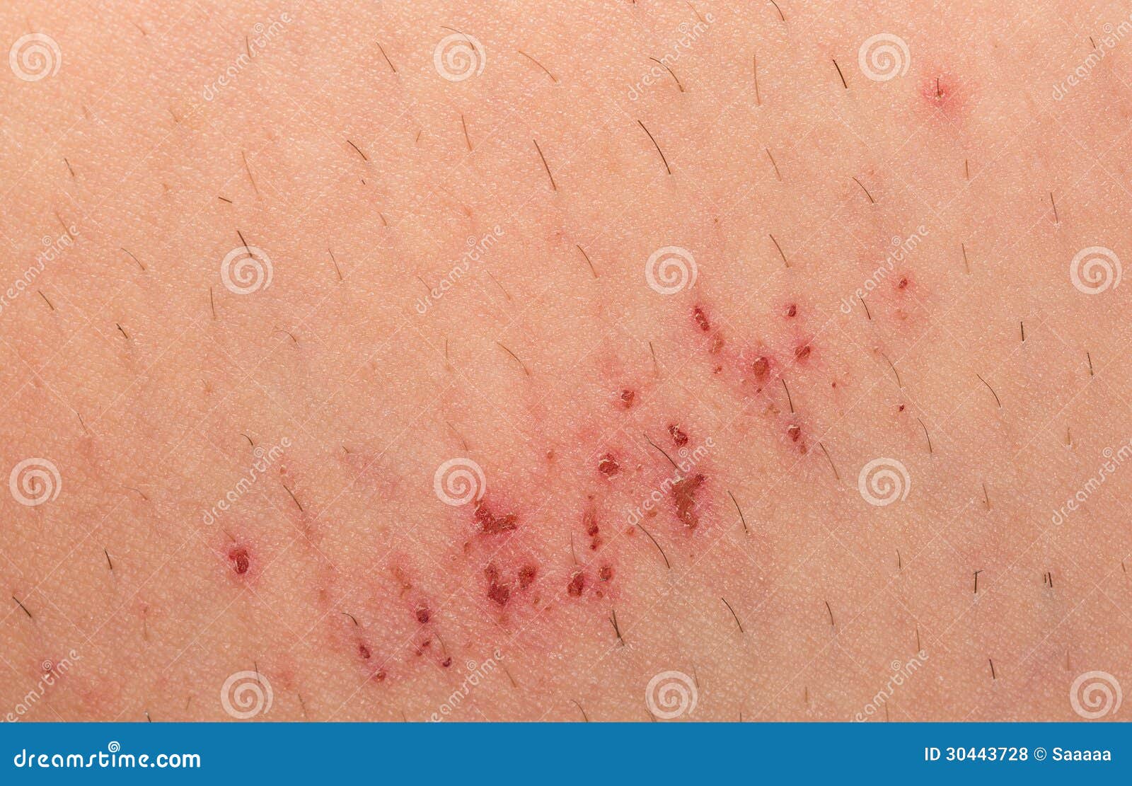 Scratch stock photo. Image of detailed, skin, scab, caucasian - 30443728