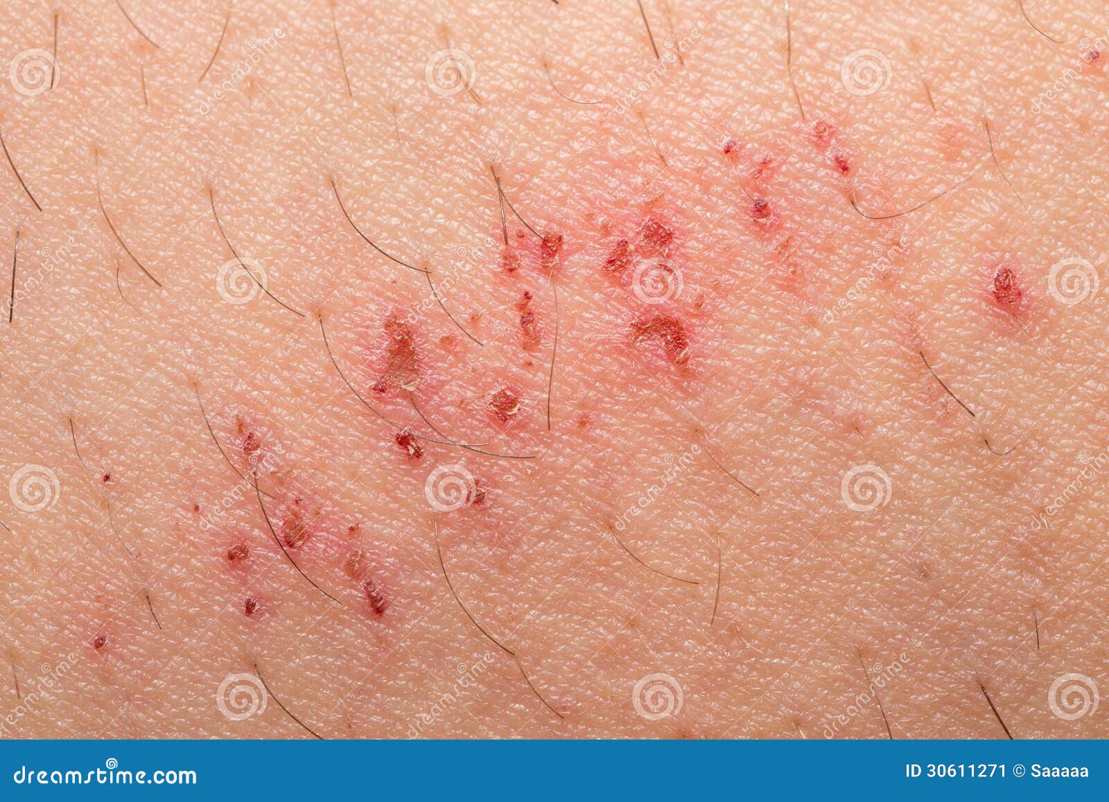 Scratch stock image. Image of closeup, white, scab, caucasian - 30611271