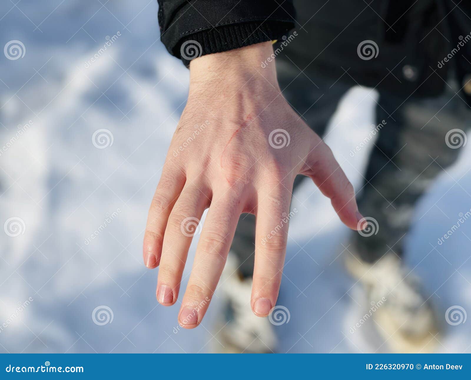 Scratch on a Hand, Close Up Stock Photo - Image of person, hand: 226320970