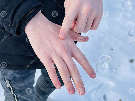 Scratch on a Hand, Close Up Stock Image - Image of scratch, person ...