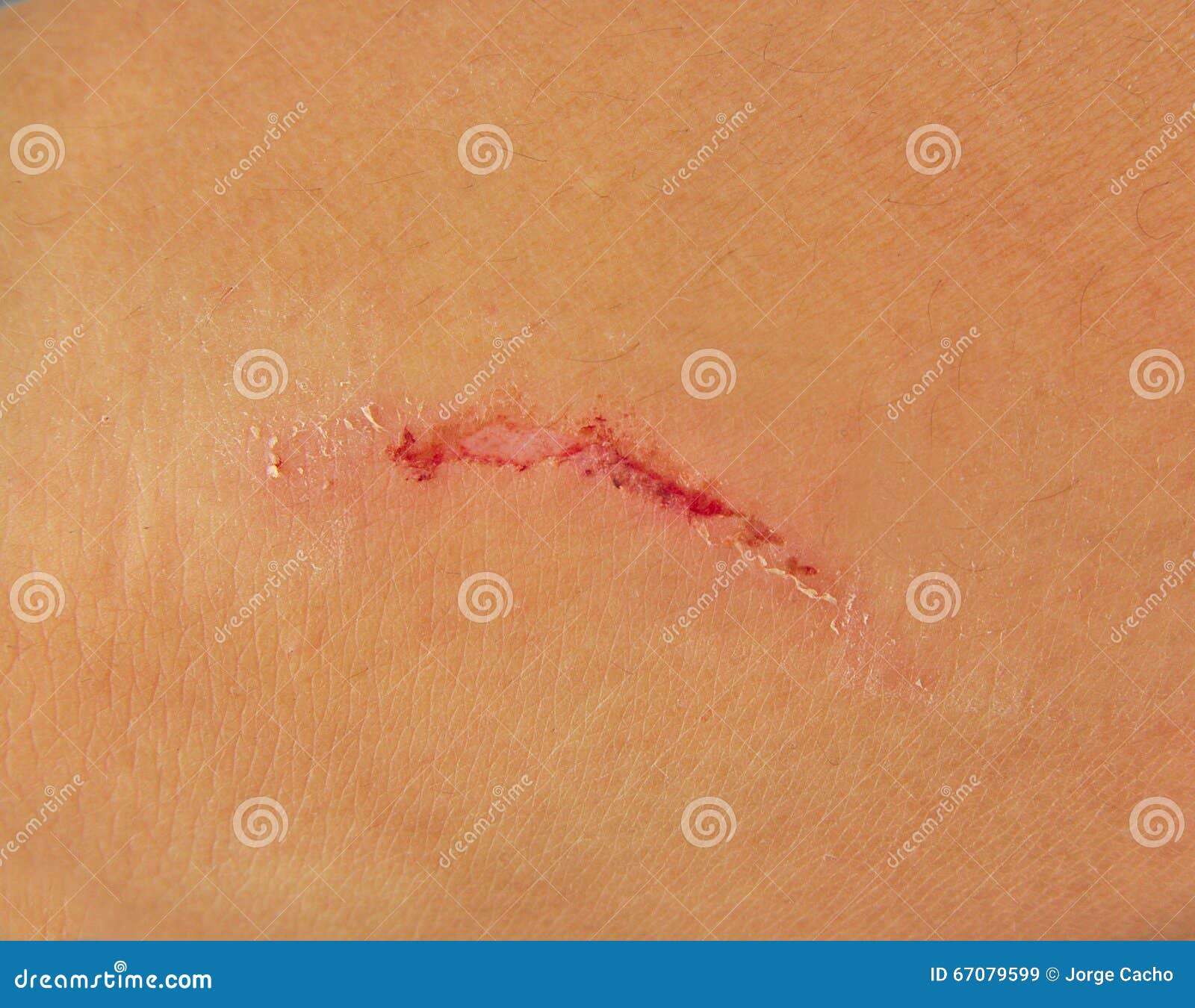 Scratch on Human Skin in White Background Stock Image - Image of hurt ...