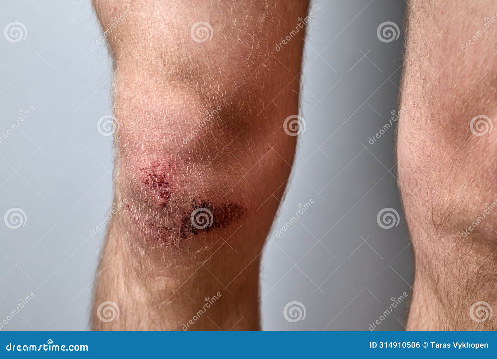 Scratch, Knee Wound on a Man& X27;s Knee Stock Photo - Image of ...