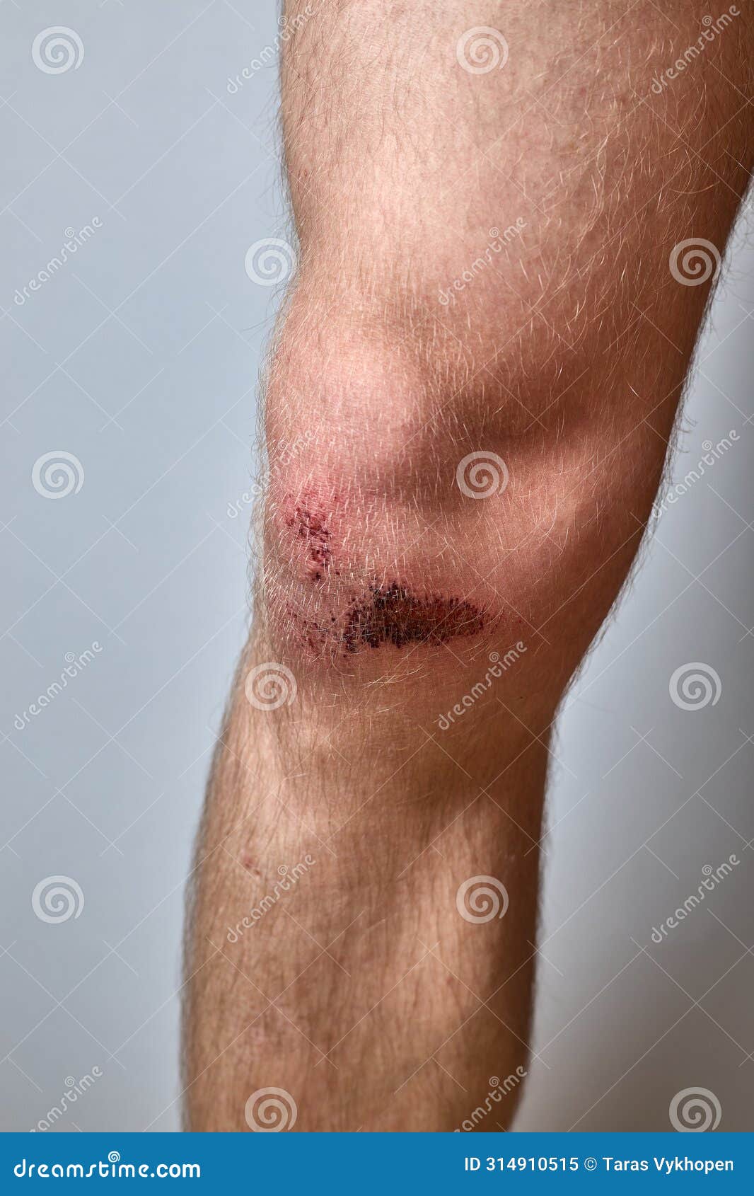 Scratch, Knee Wound on a Man& X27;s Knee Stock Image - Image of skin ...
