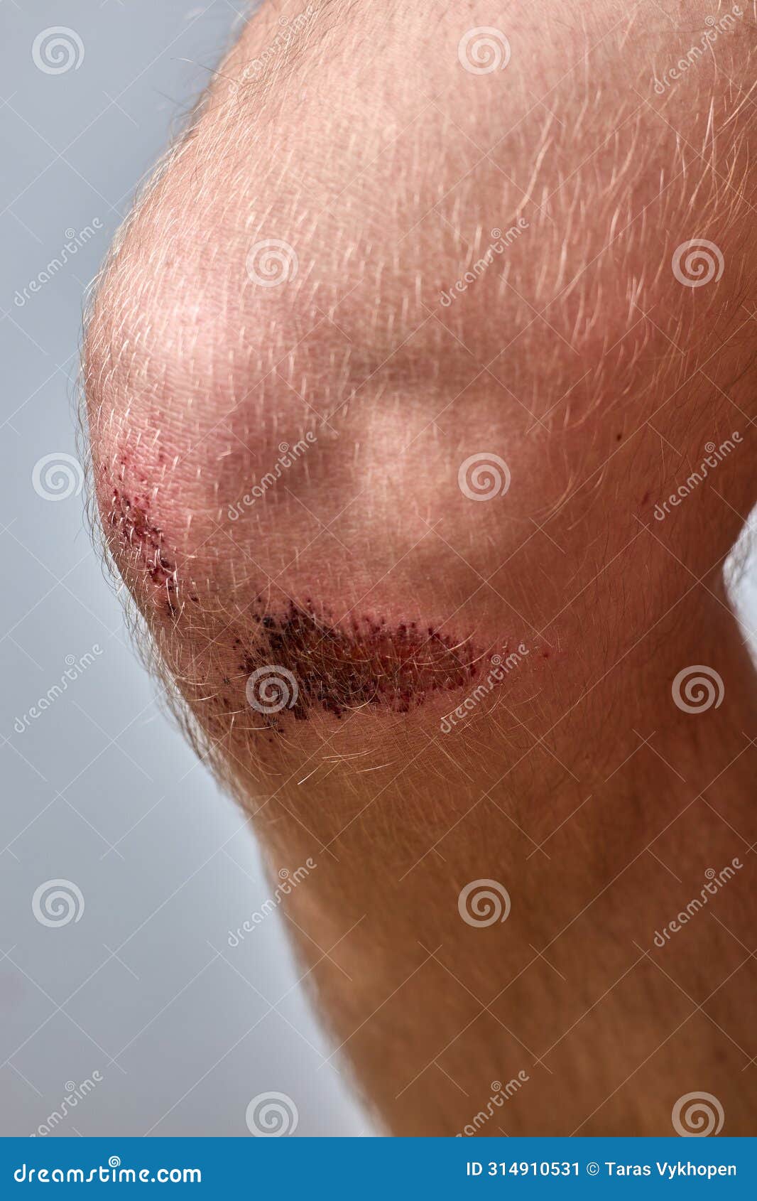 Scratch, Knee Wound on a Man& X27;s Knee Stock Image - Image of people ...