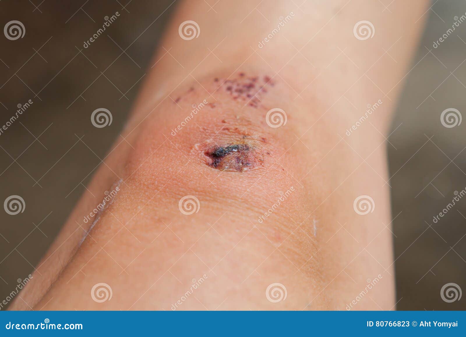 Scratch on the knee. stock image. Image of closeup, human - 80766823